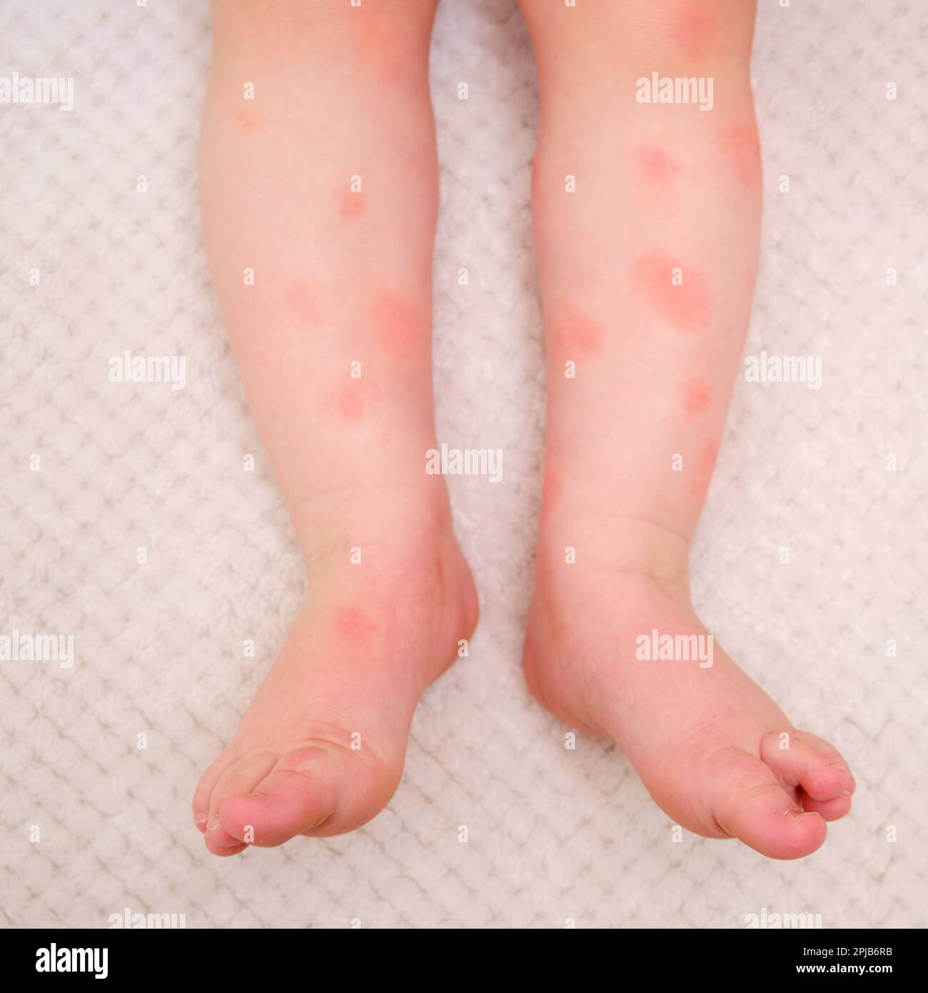Toddler baby skin care, allergies and dermatitis. Red spots of allergy ...