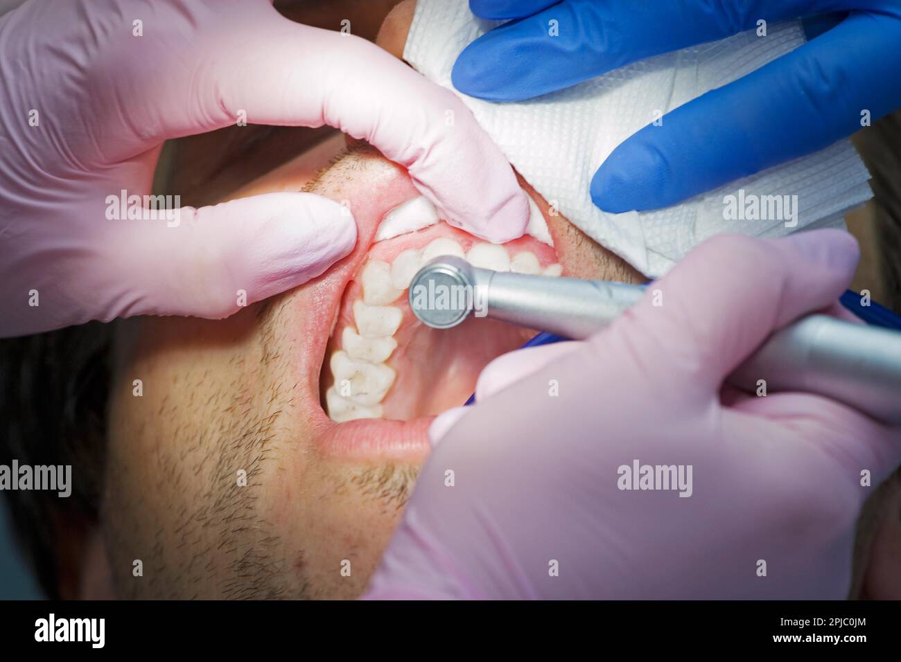 dentist grinds the front teeth to the patient Stock Photo - Alamy