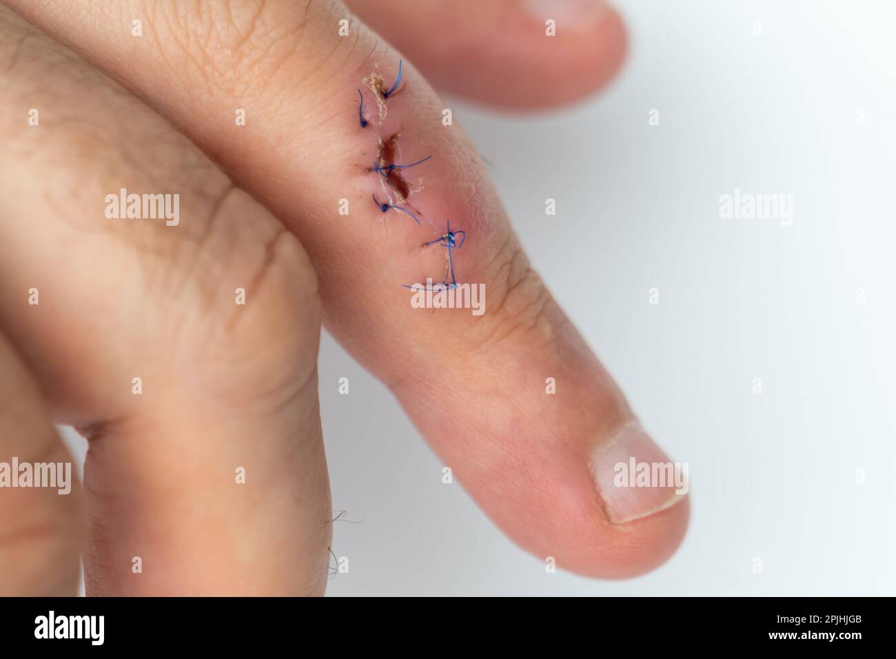 Stitched wound hi-res stock photography and images - Alamy