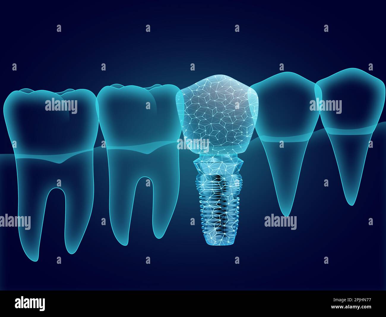Illustration of teeth and dental implant on dark blue background Stock ...