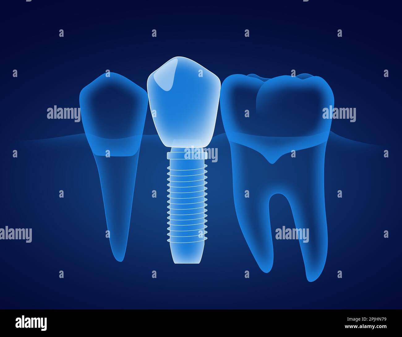 Illustration of teeth and dental implant on dark blue background Stock ...