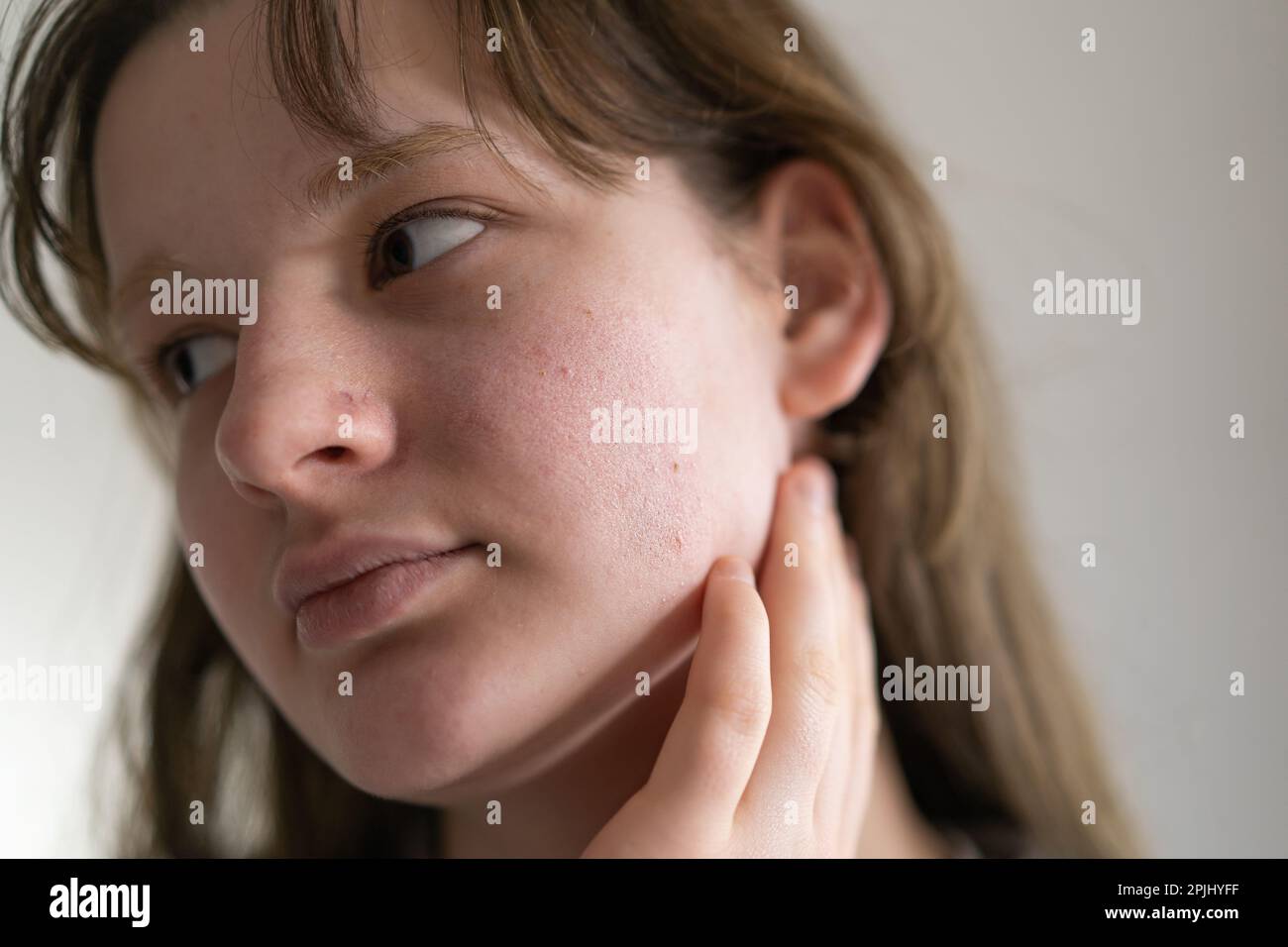 Problem skin face. A teenage girl with a troubled face Stock Photo - Alamy