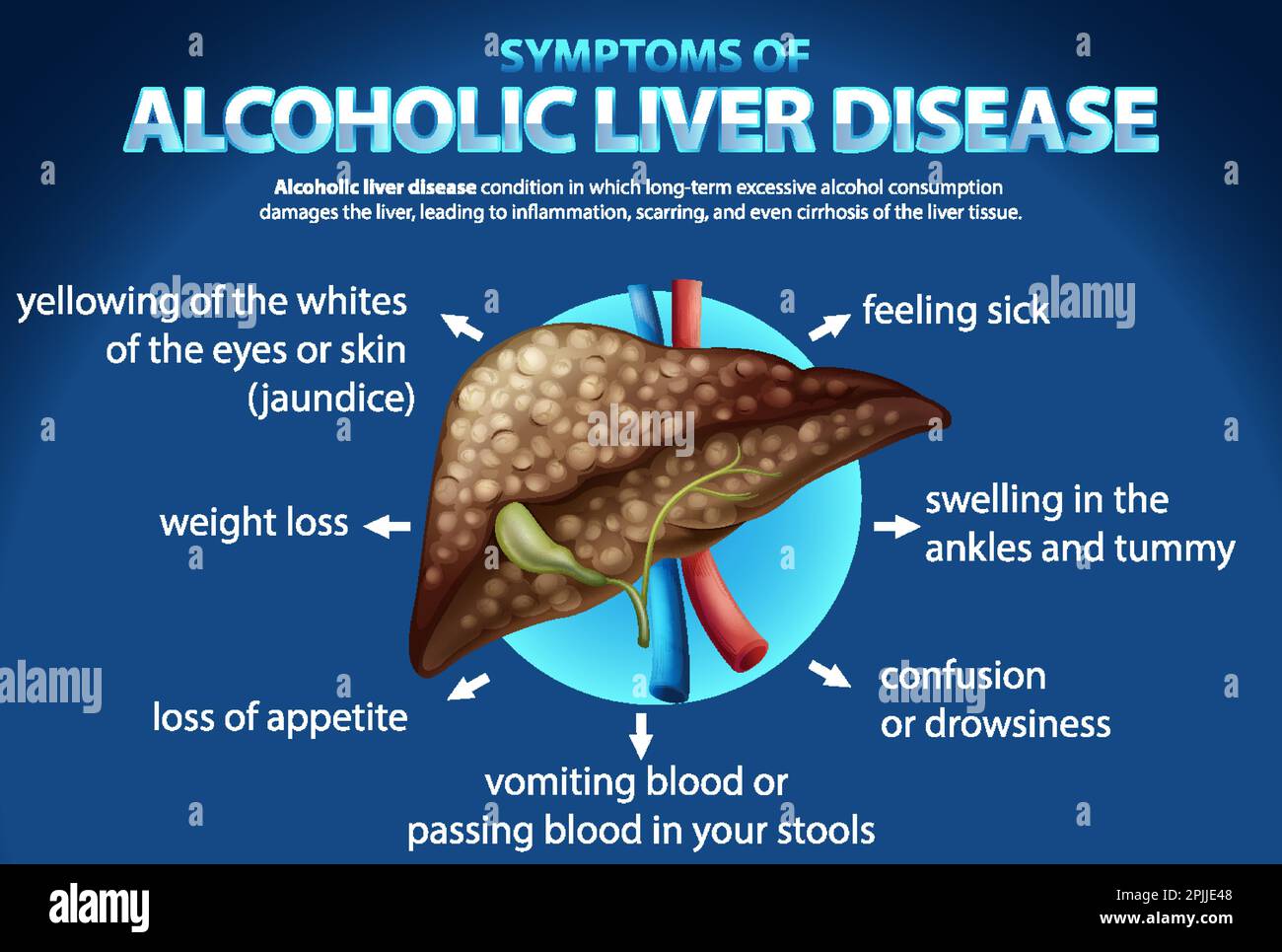 Informative poster of alcoholic liver disease Cirrhosis illustration ...
