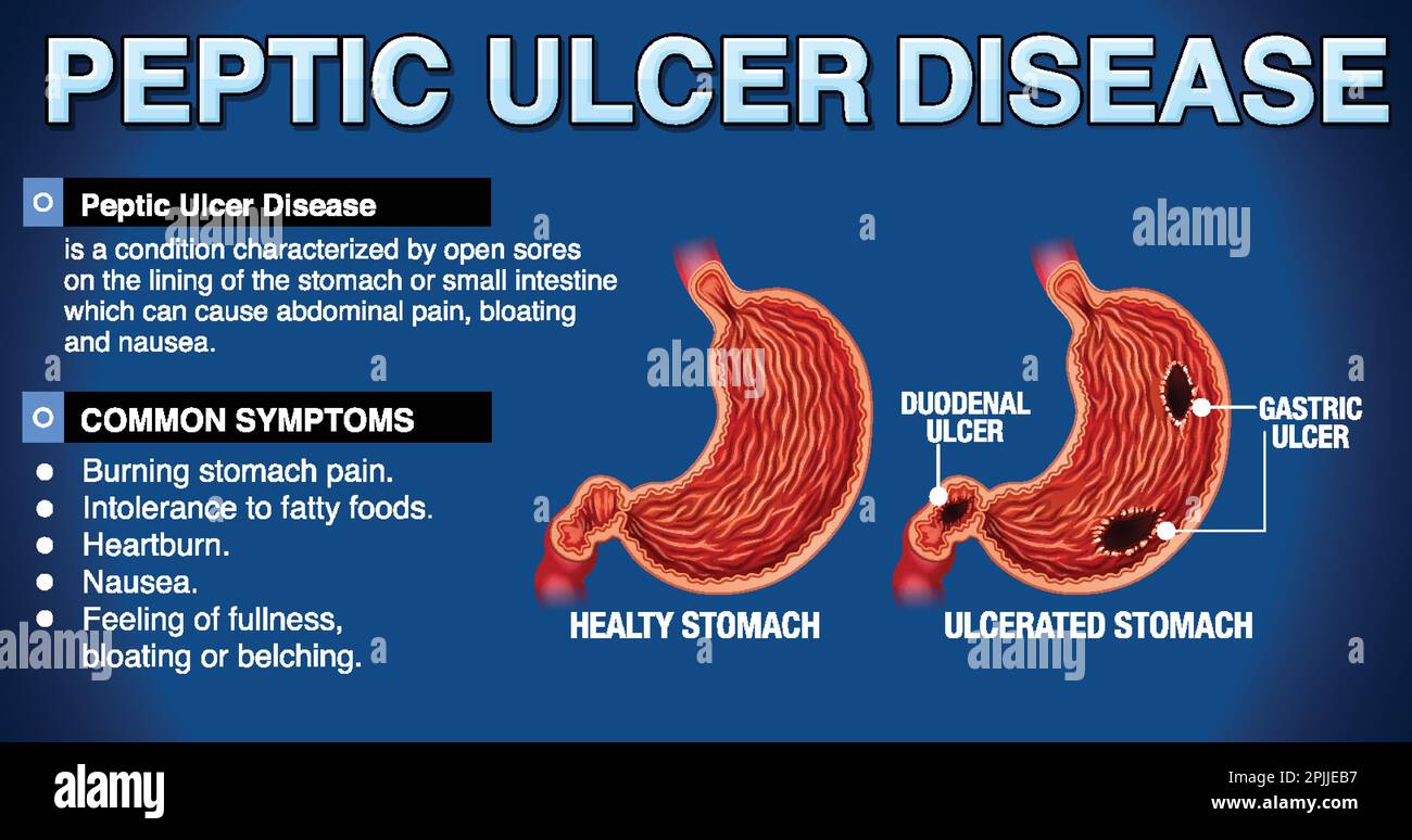 Peptic Ulcer Disease Explained Infographic Illustration Stock Vector