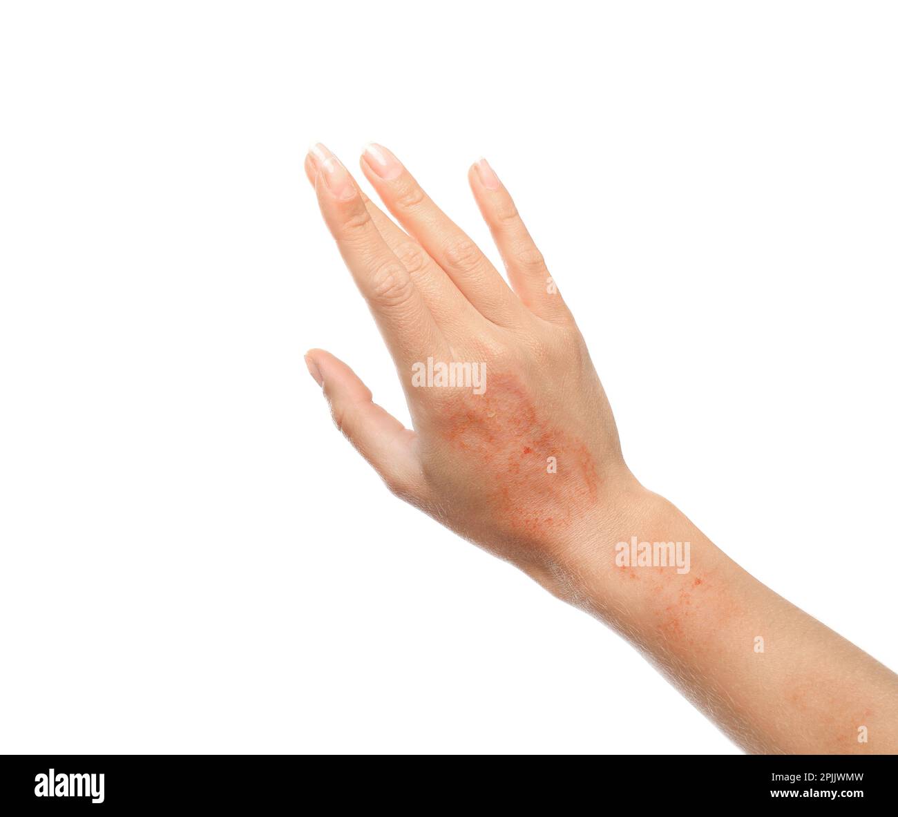 Woman showing hand with dry skin on white background, closeup Stock ...