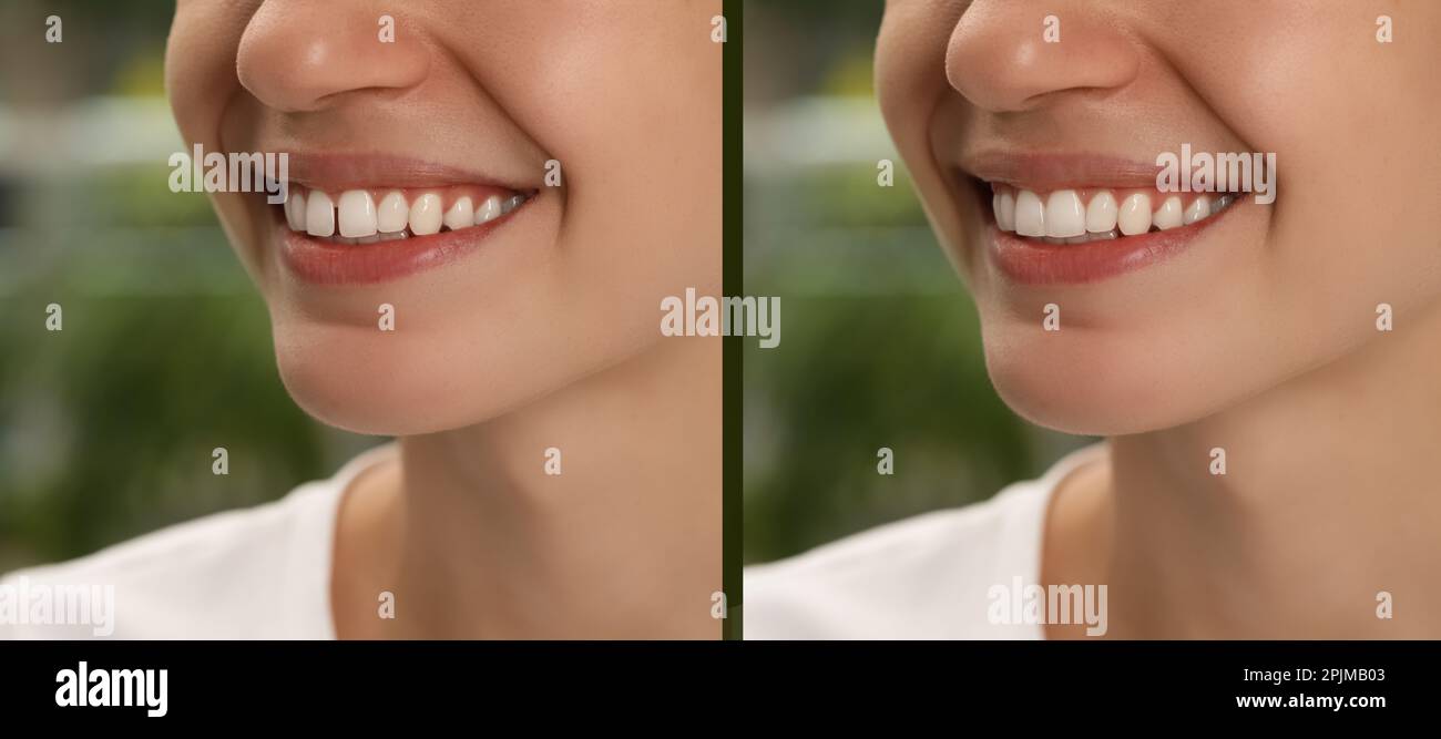 Collage with photos of woman with diastema between upper front teeth ...