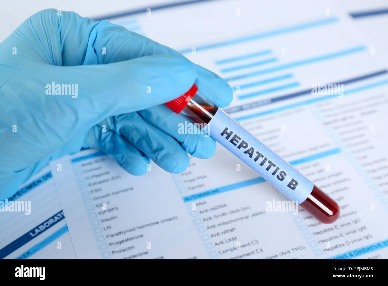 Scientist holding tube with blood sample and label Hepatitis B against ...