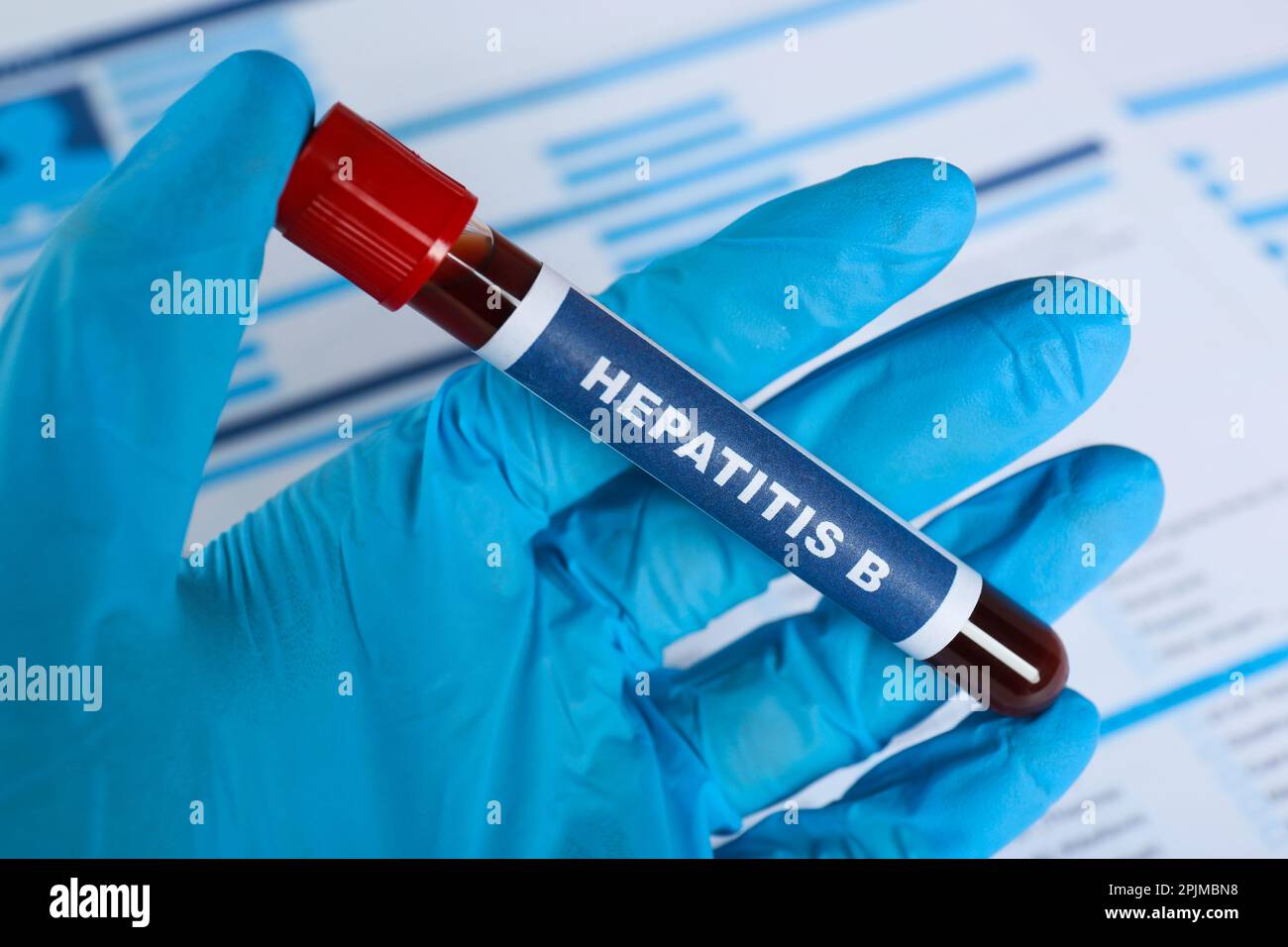 Scientist holding tube with blood sample and label Hepatitis B against ...