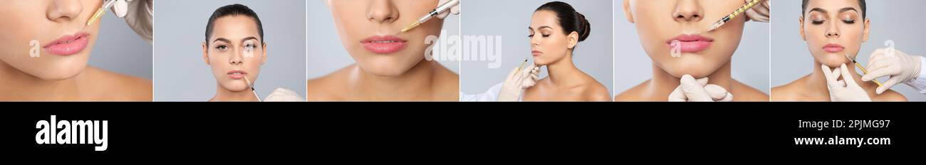 Collage with photos of woman during lip augmentation procedure. Banner ...