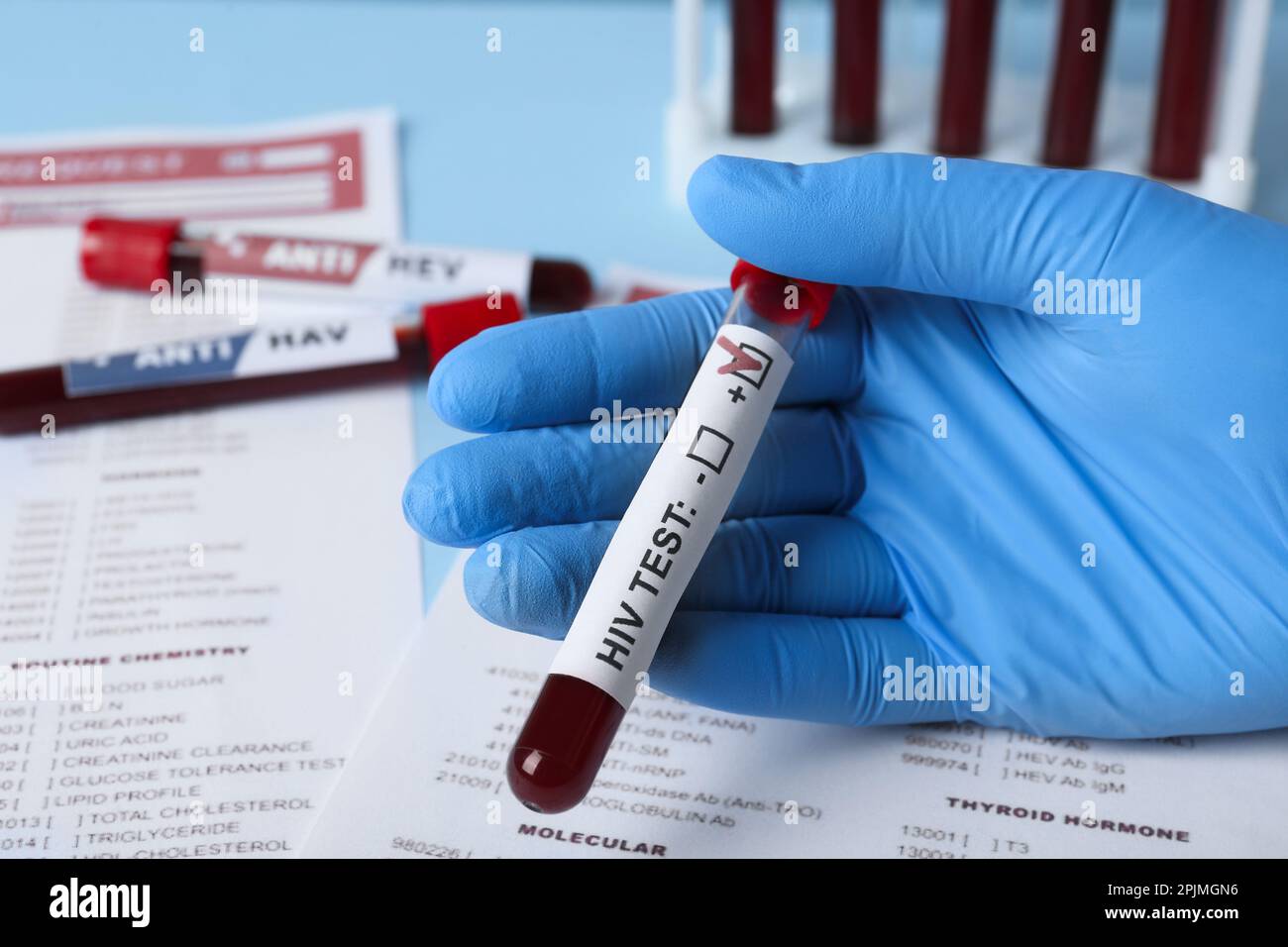 Scientist holding tube with blood sample and label HIV Test near ...