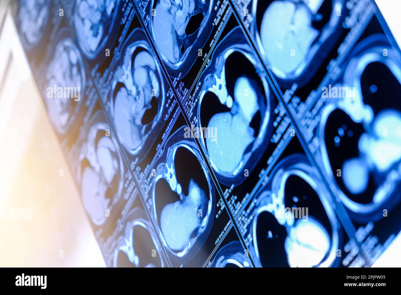 Computed tomography (CT) of the chest. Medical background. Monochrome ...