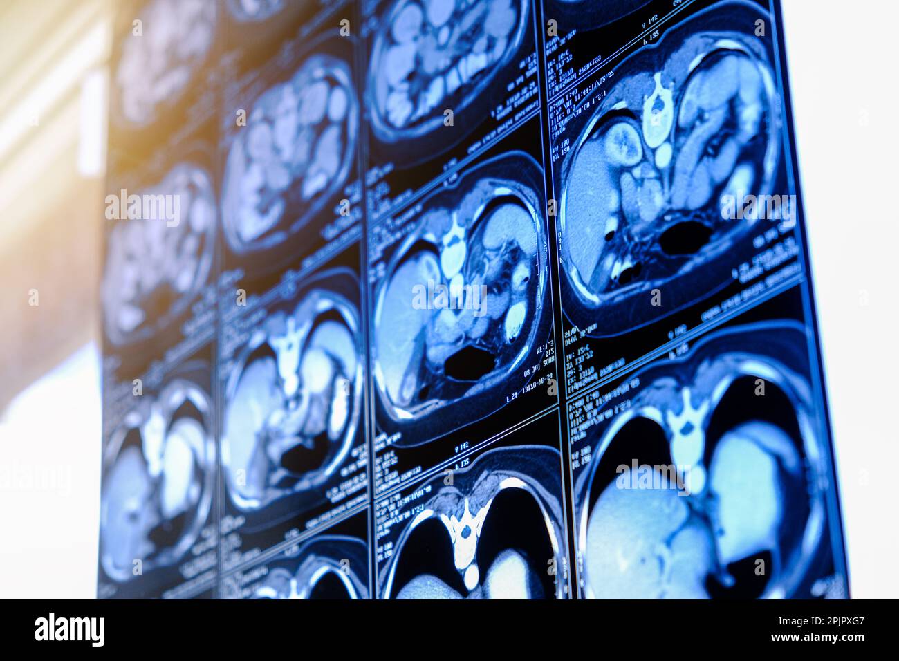 Computed tomography (CT) of the chest. Medical background. Monochrome ...