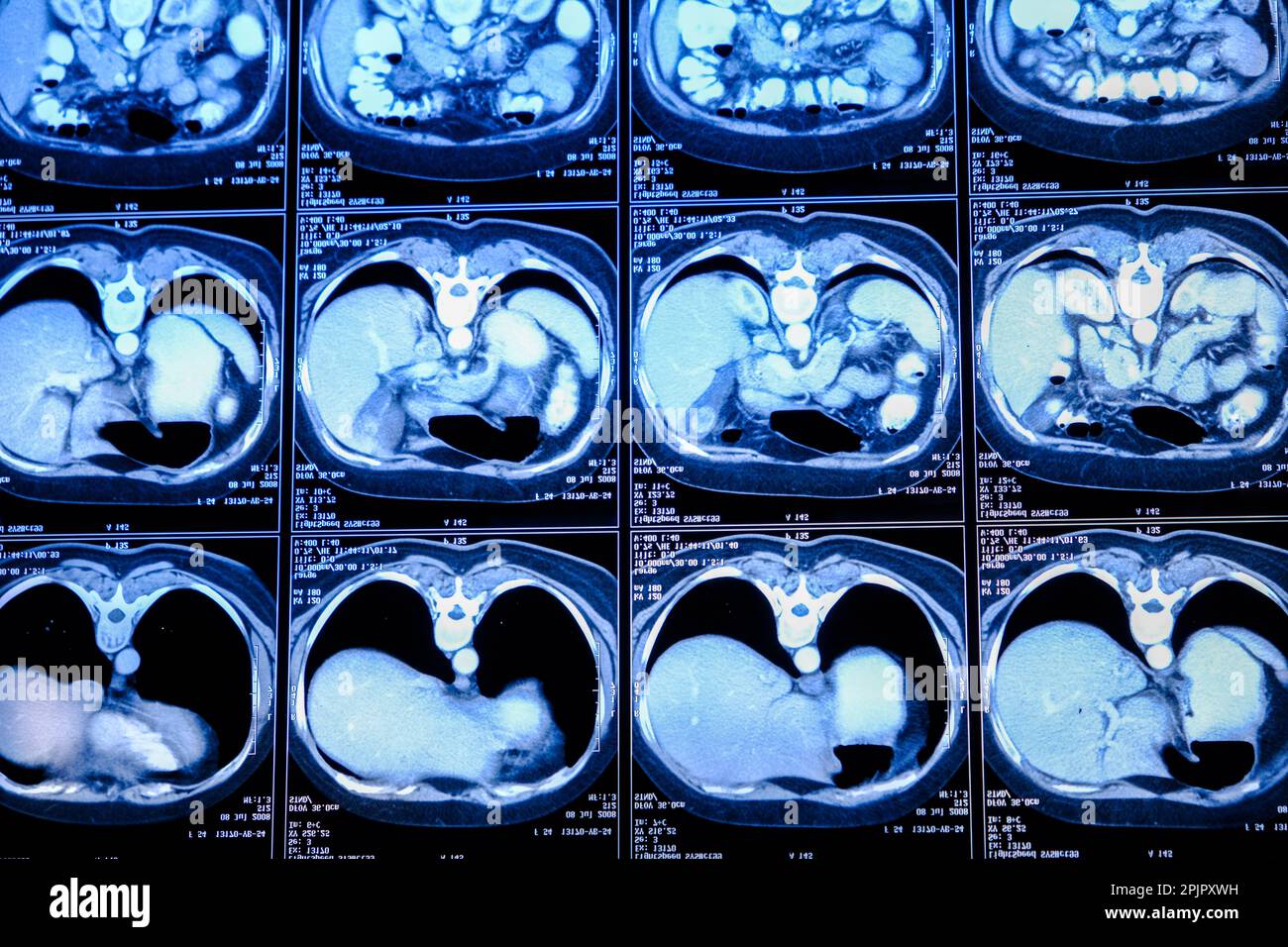 Computed tomography (CT scan) of chest with abdomen Stock Photo - Alamy