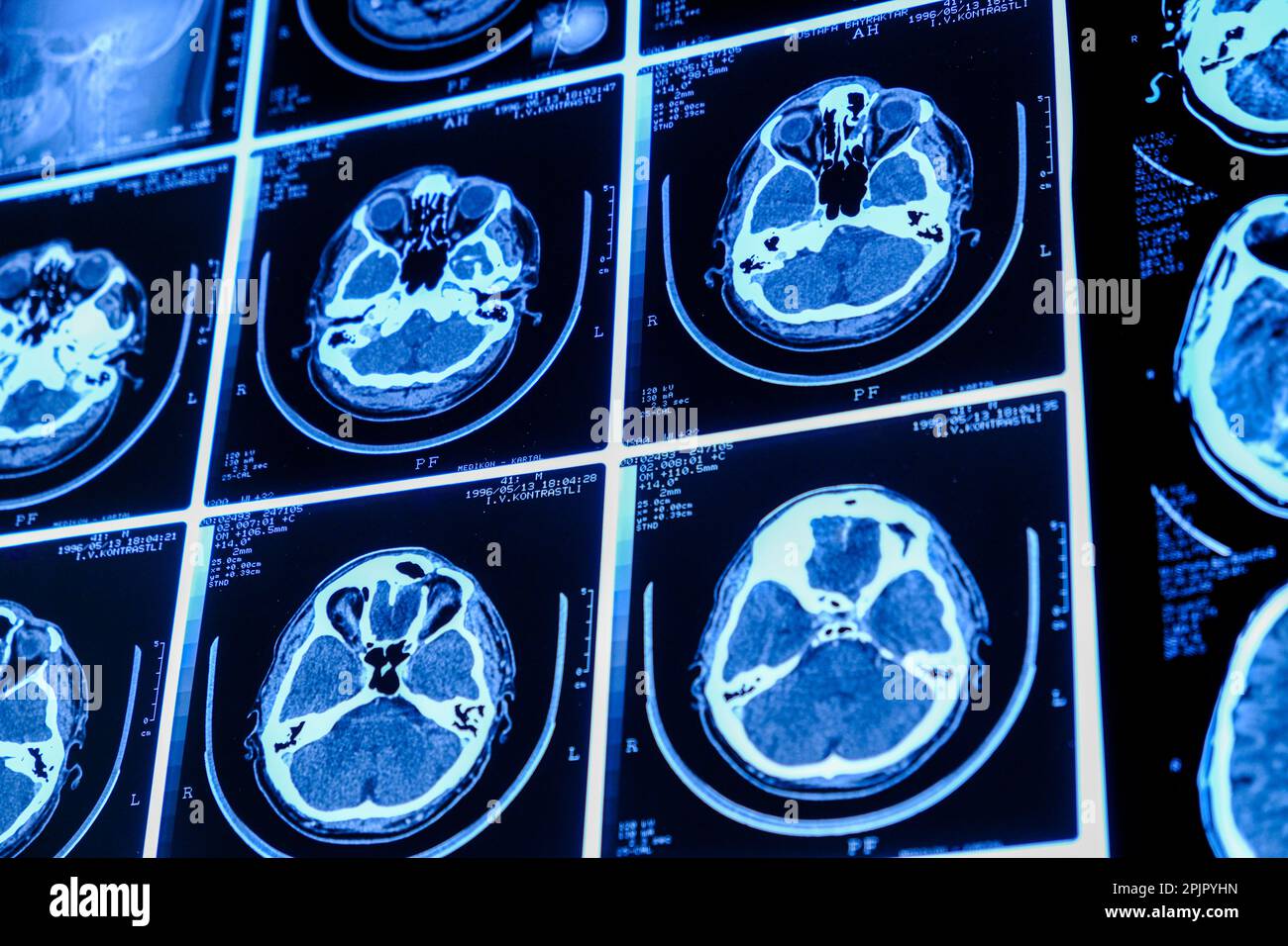 Close-up of CT scan with brain. Medicine, science and education MRI ...