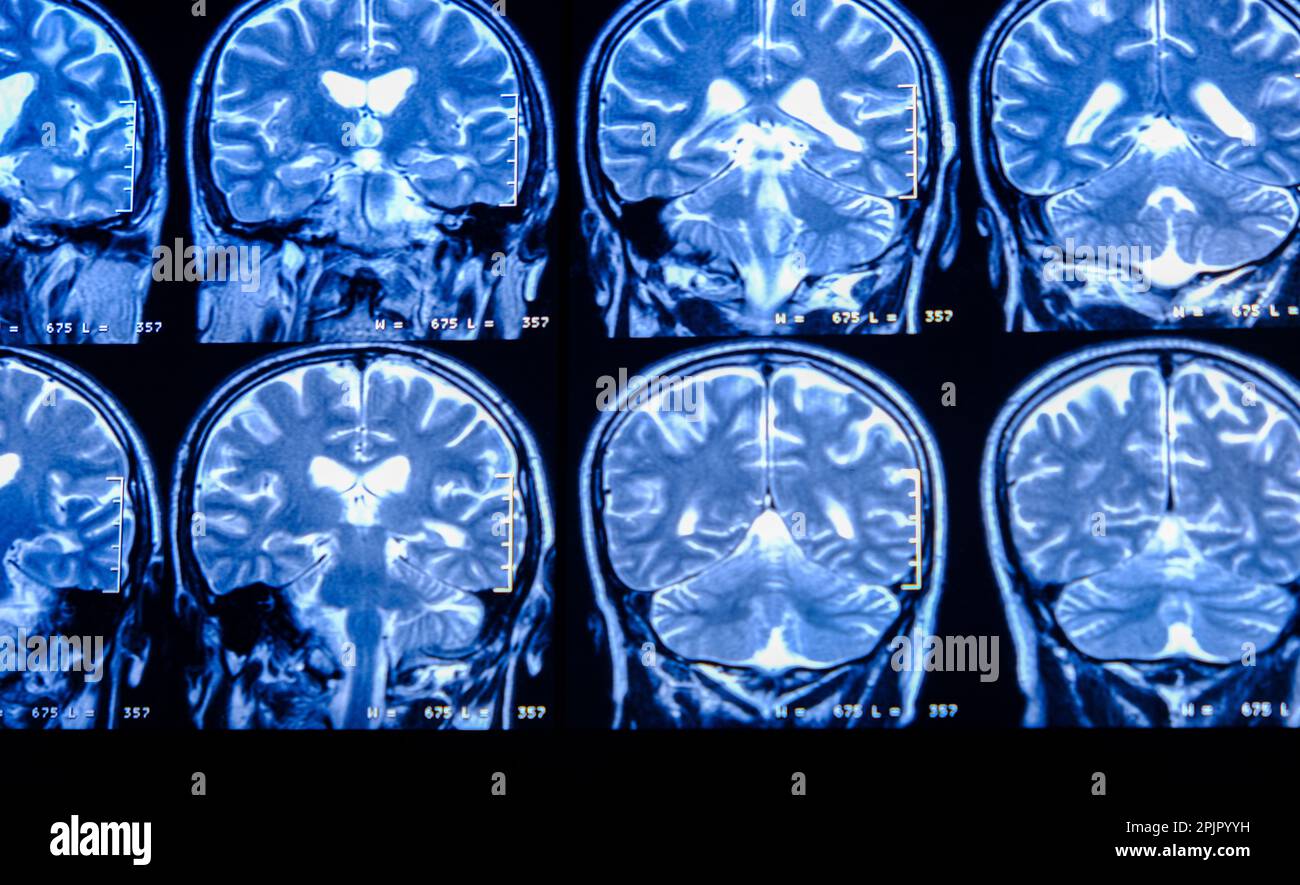 Close-up of CT scan with brain. Medicine, science and education MRI ...