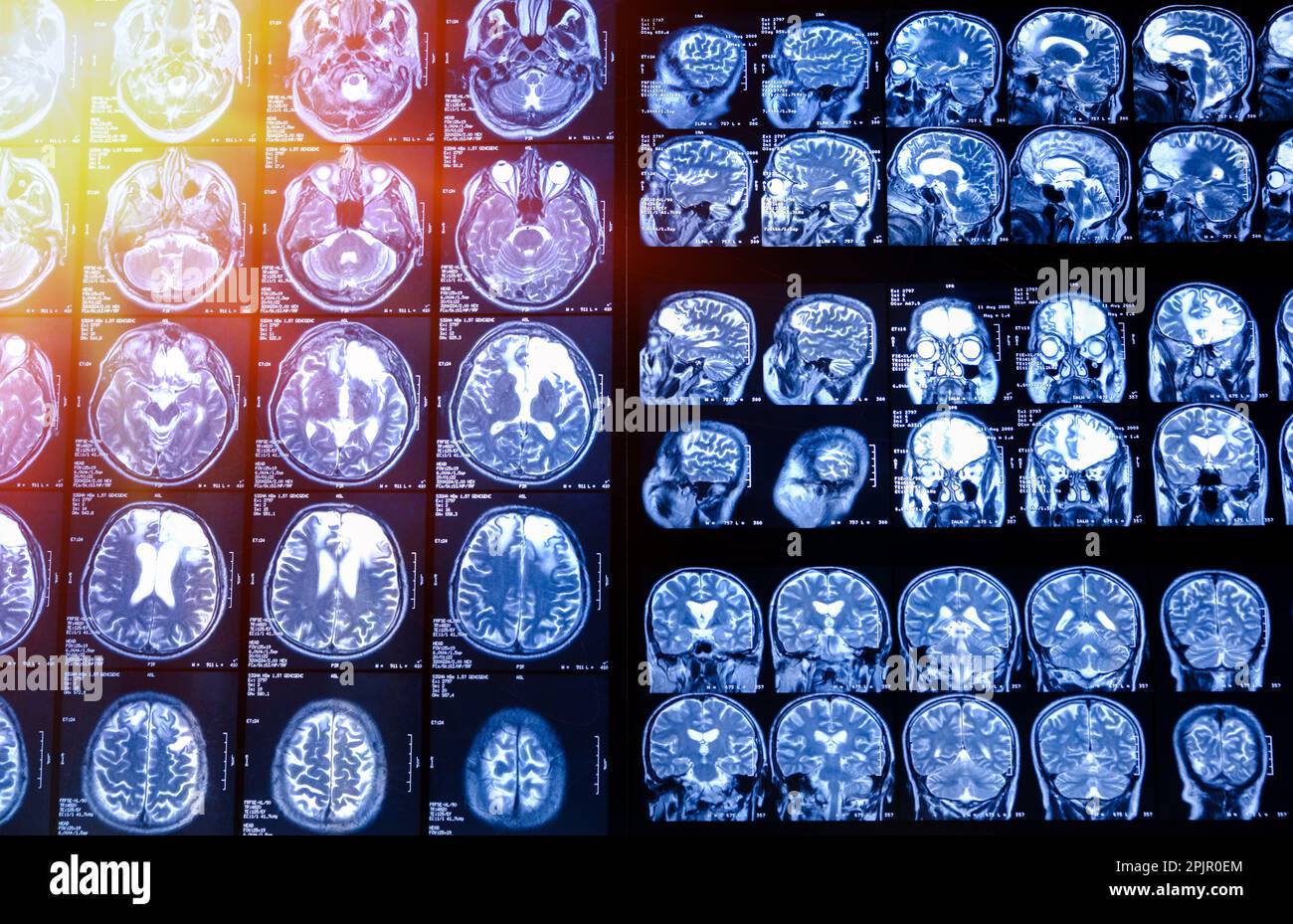 MRI scan of the brain for diagnosis. Medical examination for health ...