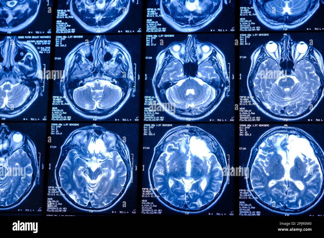 MRI scan of the brain for diagnosis. Medical examination for health ...