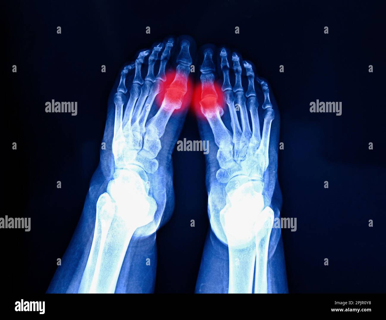 Film x-ray foot radiograph show pain area with red, isolated on dark ...