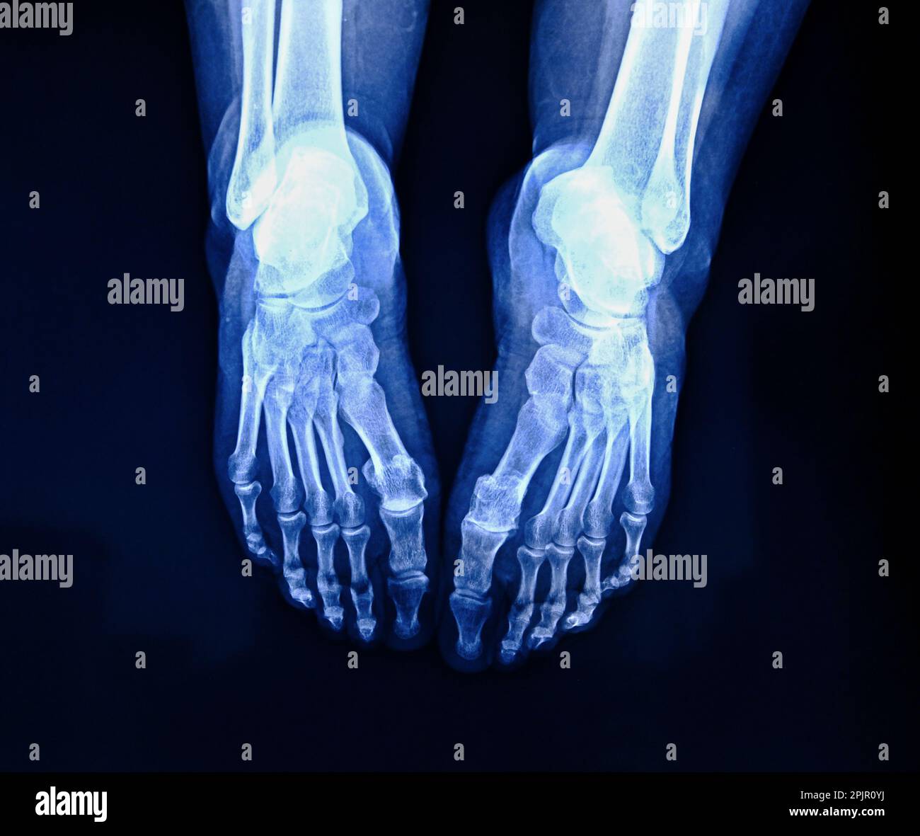 X-ray of foot on dark background, radiograph of feet Stock Photo - Alamy