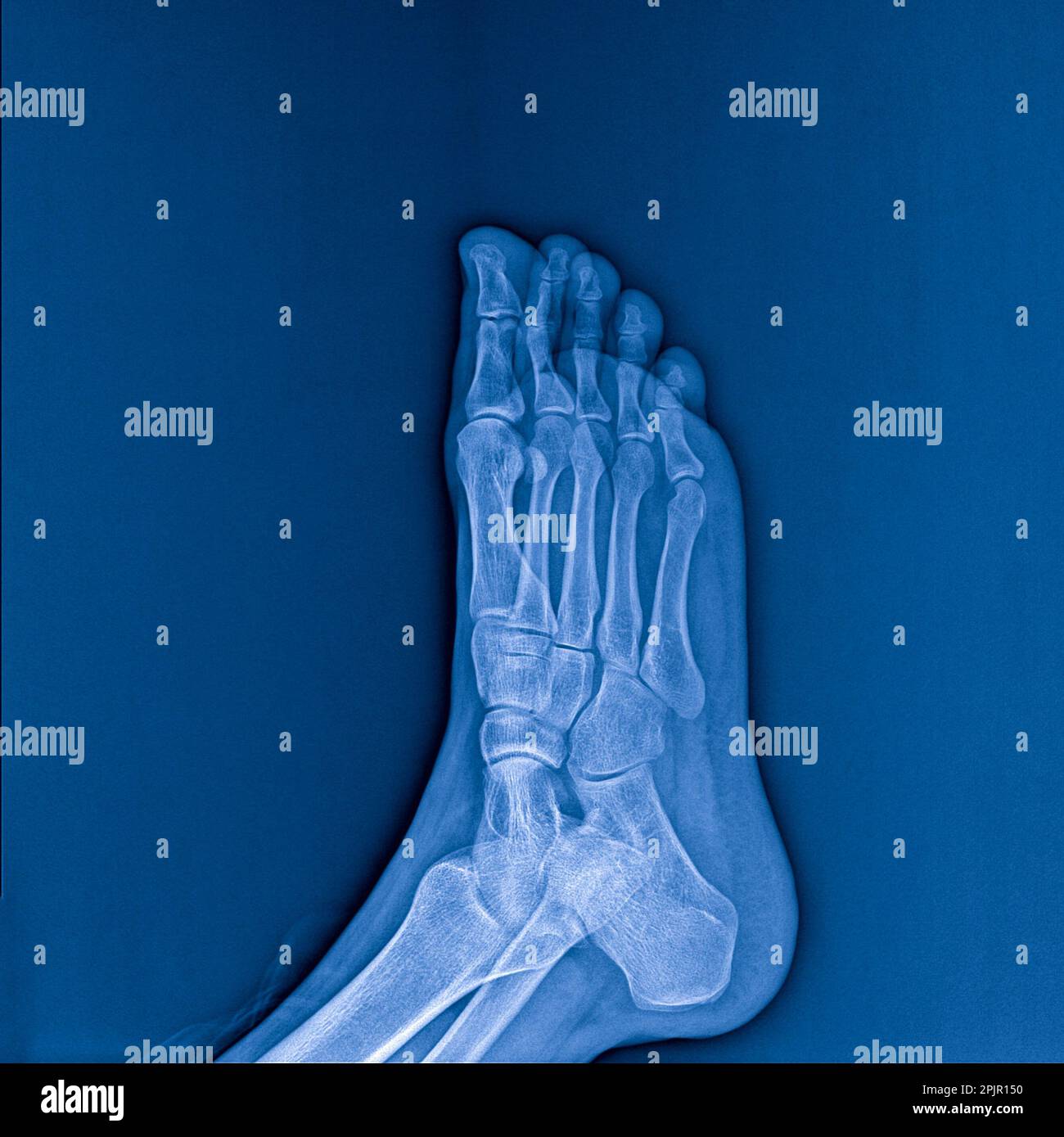 X-ray of foot on dark background, radiograph Stock Photo - Alamy