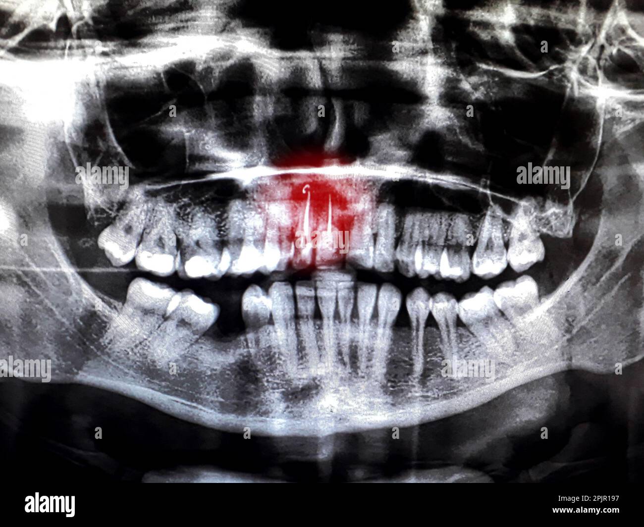 Wisdom teeth x ray hi-res stock photography and images - Alamy