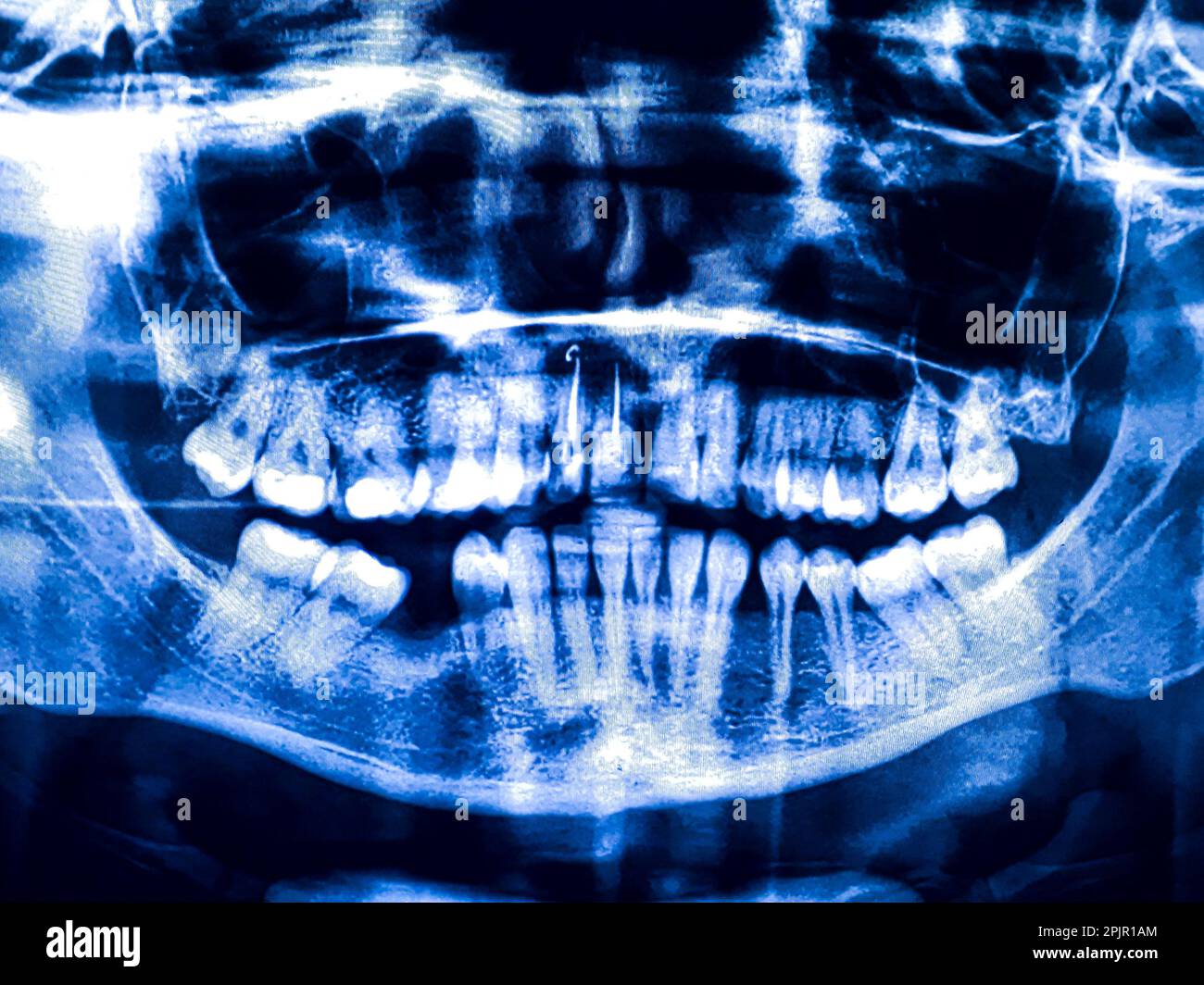 Panoramic dental tooth X-ray. Radiography for dental structures ...