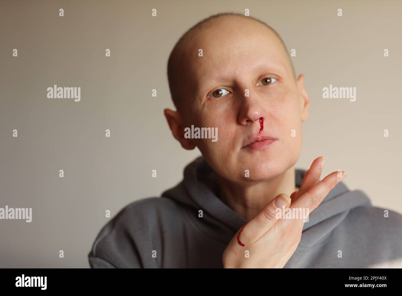 Young bald cancer sick woman is bleeding from her nose, effects of ...