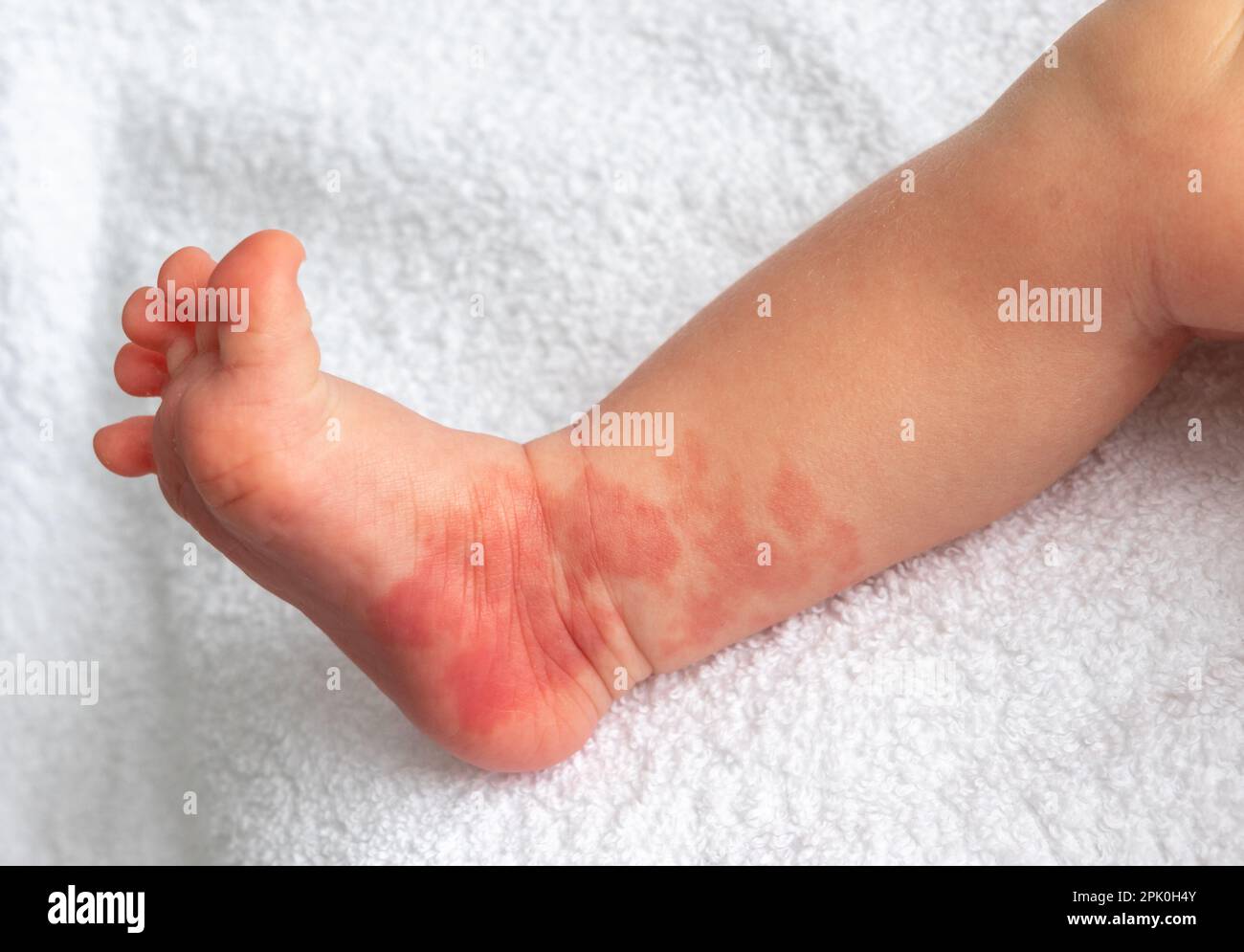 Hemangioma red birthmark on the leg of newborn baby Stock Photo - Alamy
