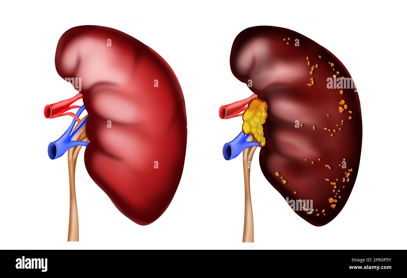 Diseased Kidney