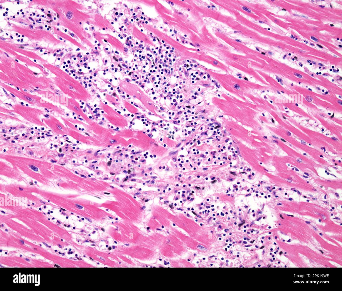 Acute cellular rejection, light micrograph Stock Photo - Alamy