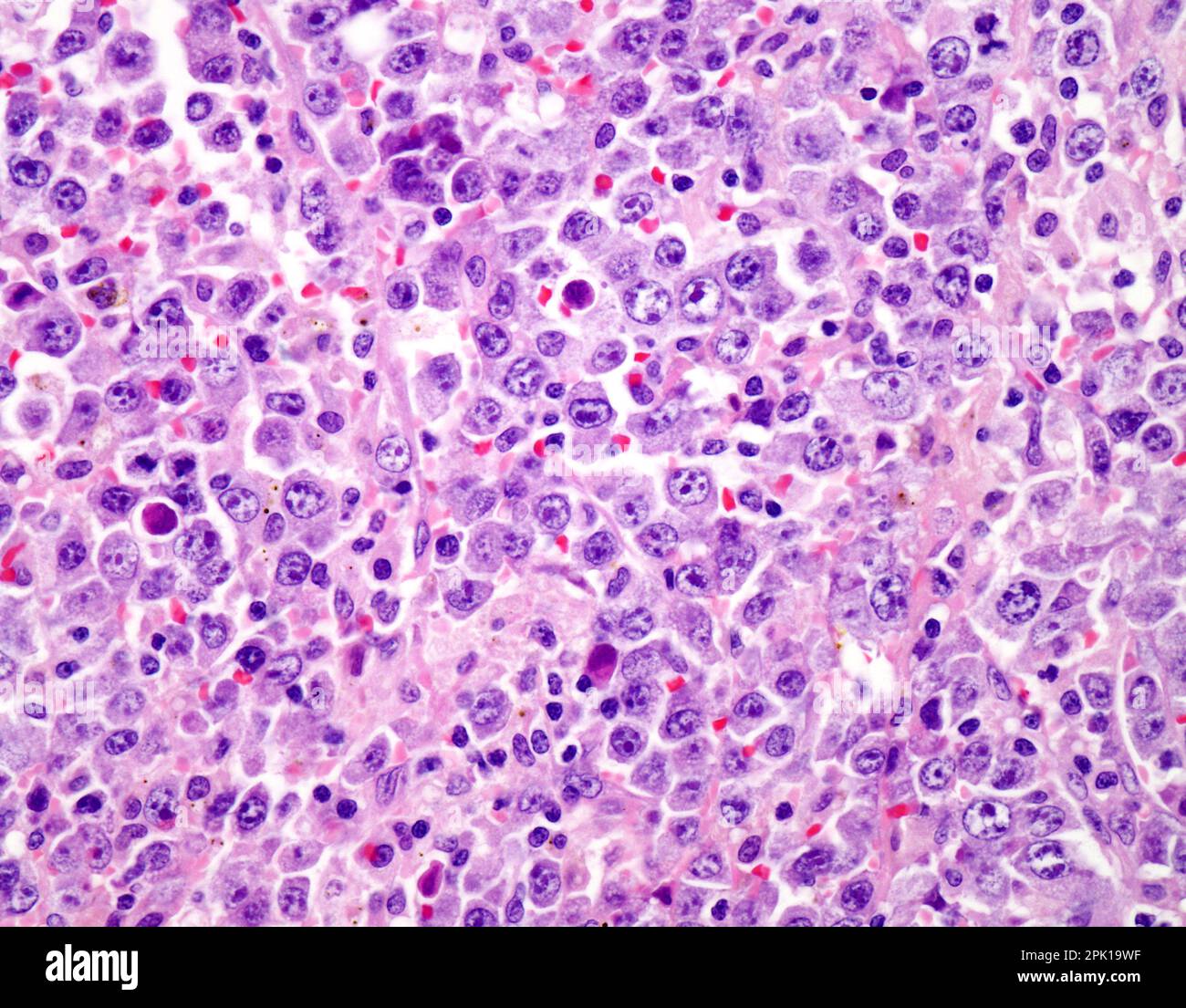 Diffuse large B cell lymphoma, light micrograph Stock Photo - Alamy