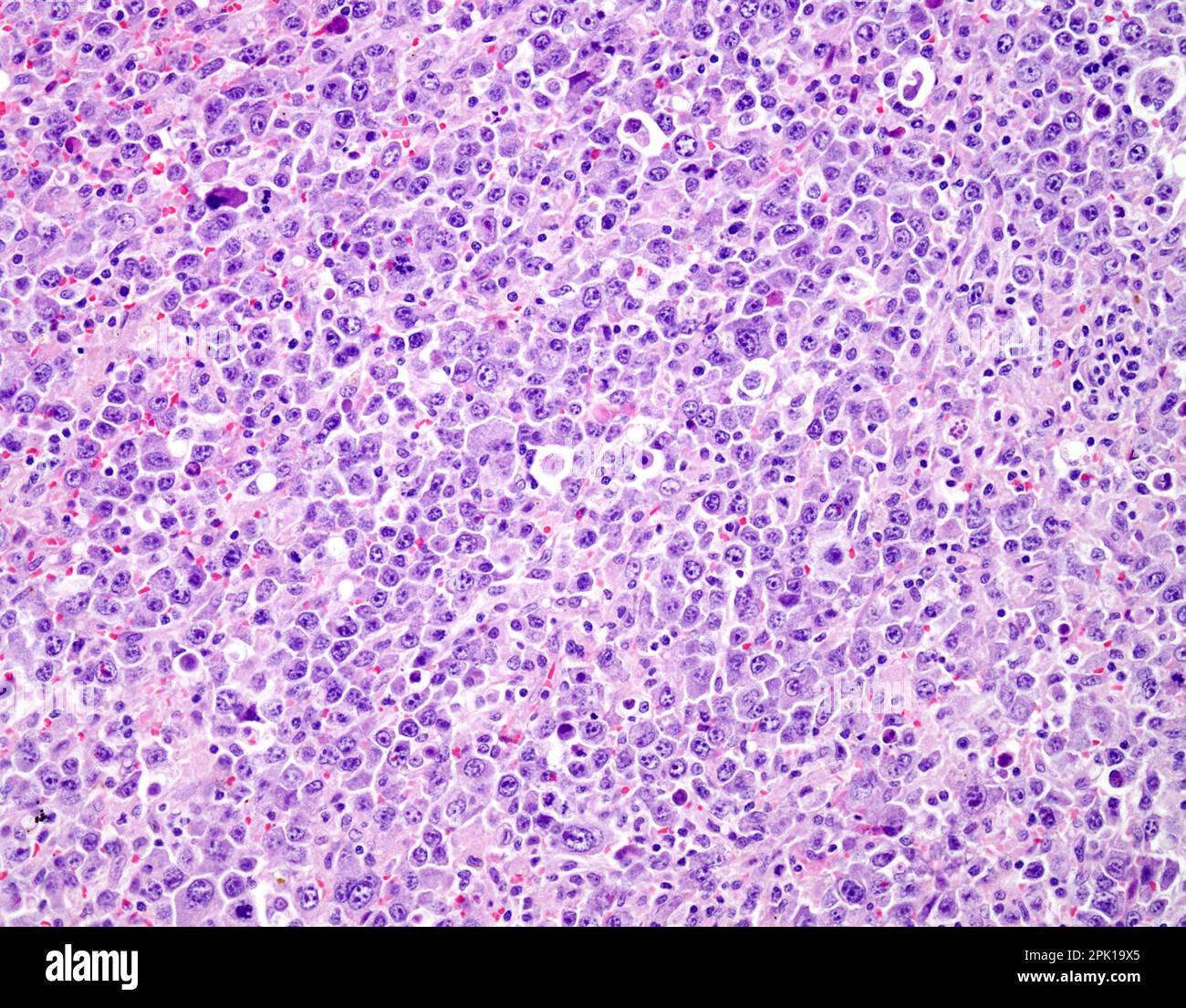 Diffuse large B cell lymphoma, light micrograph Stock Photo - Alamy
