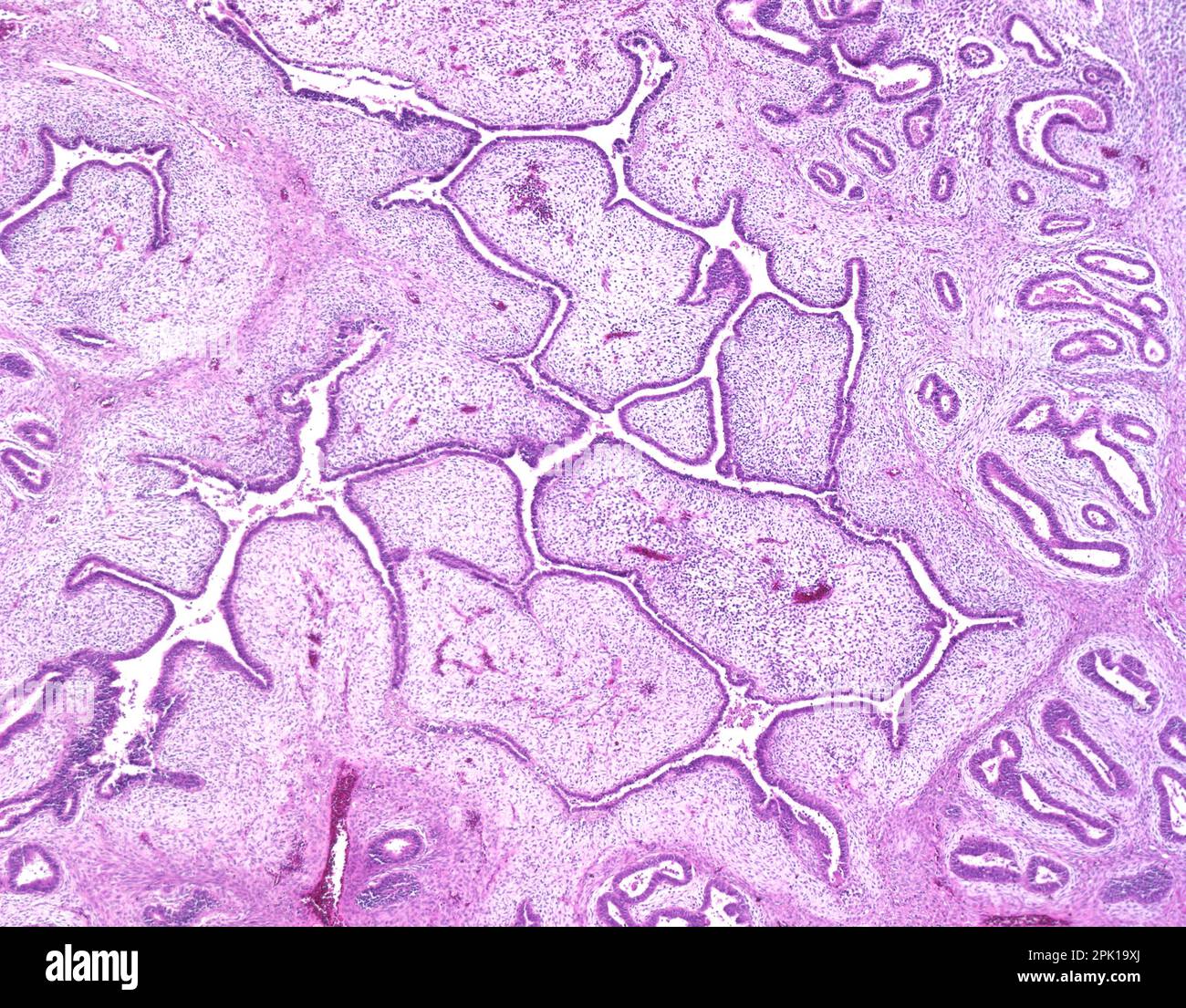 Adenosarcoma of uterus, light micrograph Stock Photo - Alamy