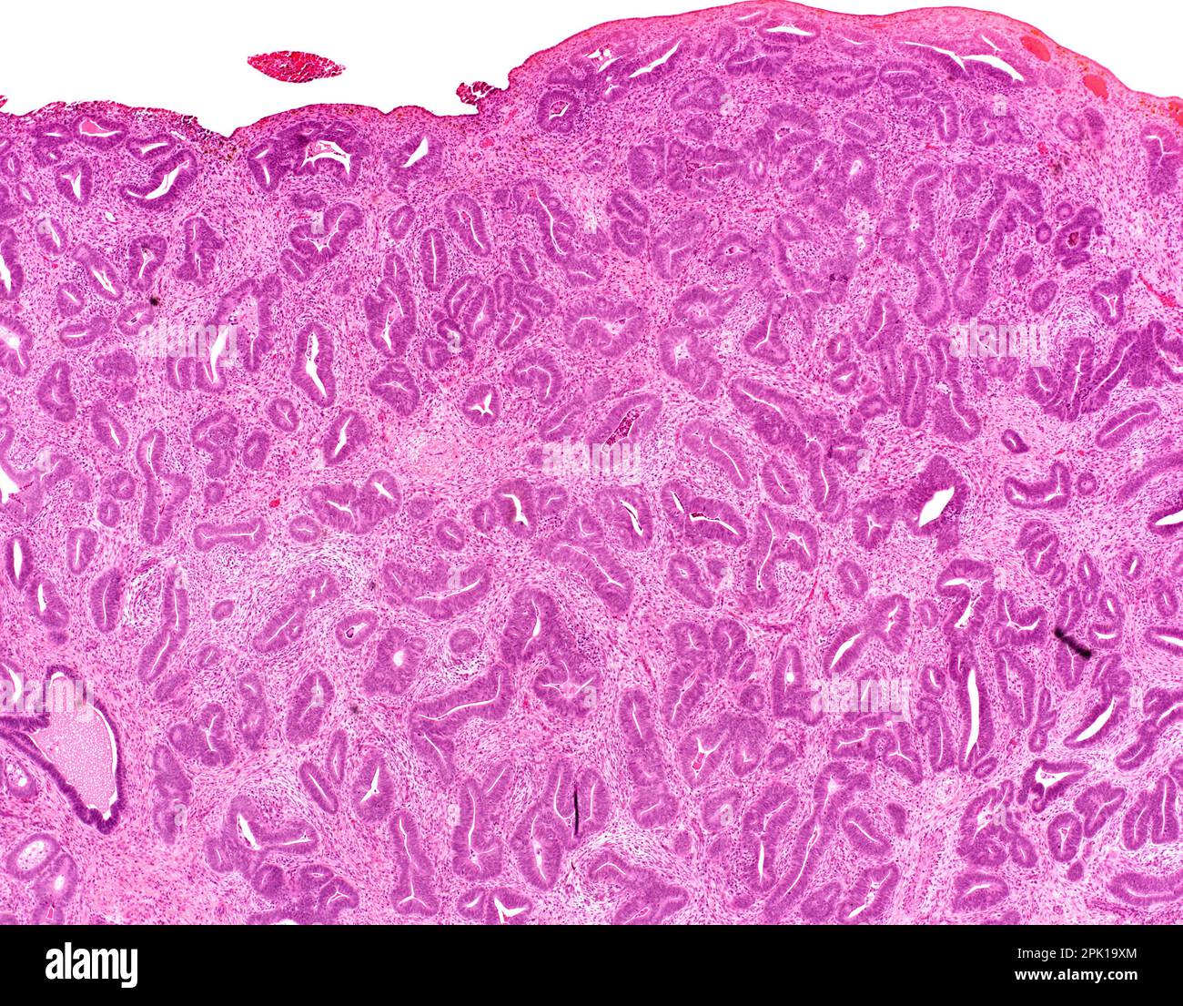 Atypical polypoid adenomyoma, light micrograph Stock Photo - Alamy