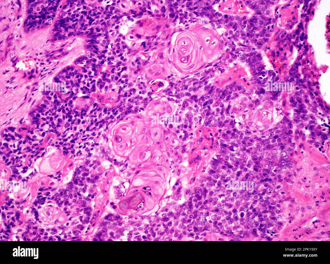 Endometrioid carcinoma of the uterus, light micrograph Stock Photo - Alamy