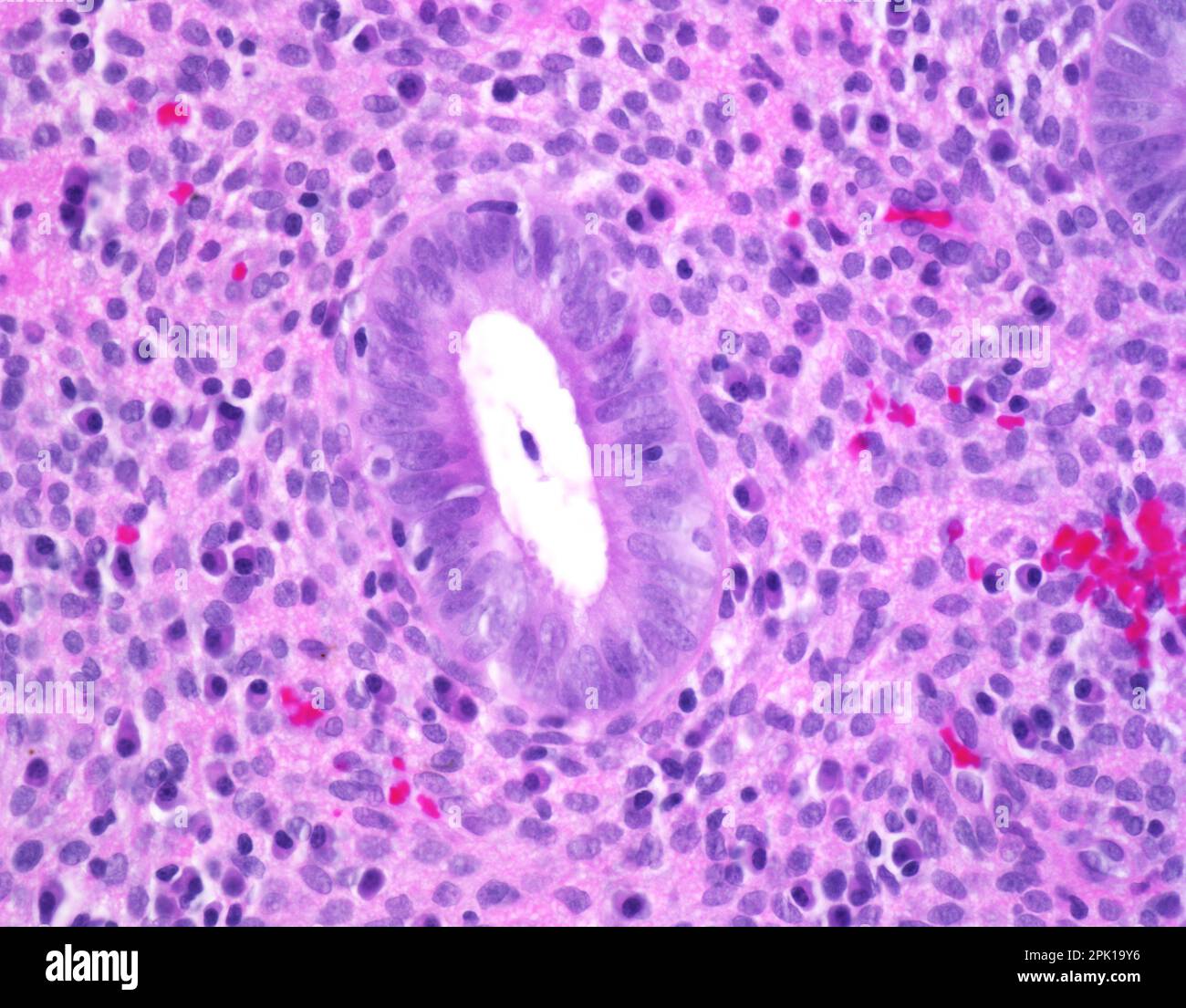 Chronic endometritis, light micrograph Stock Photo - Alamy