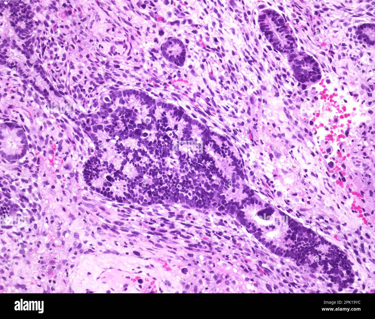 Carcinosarcoma, light micrograph Stock Photo - Alamy