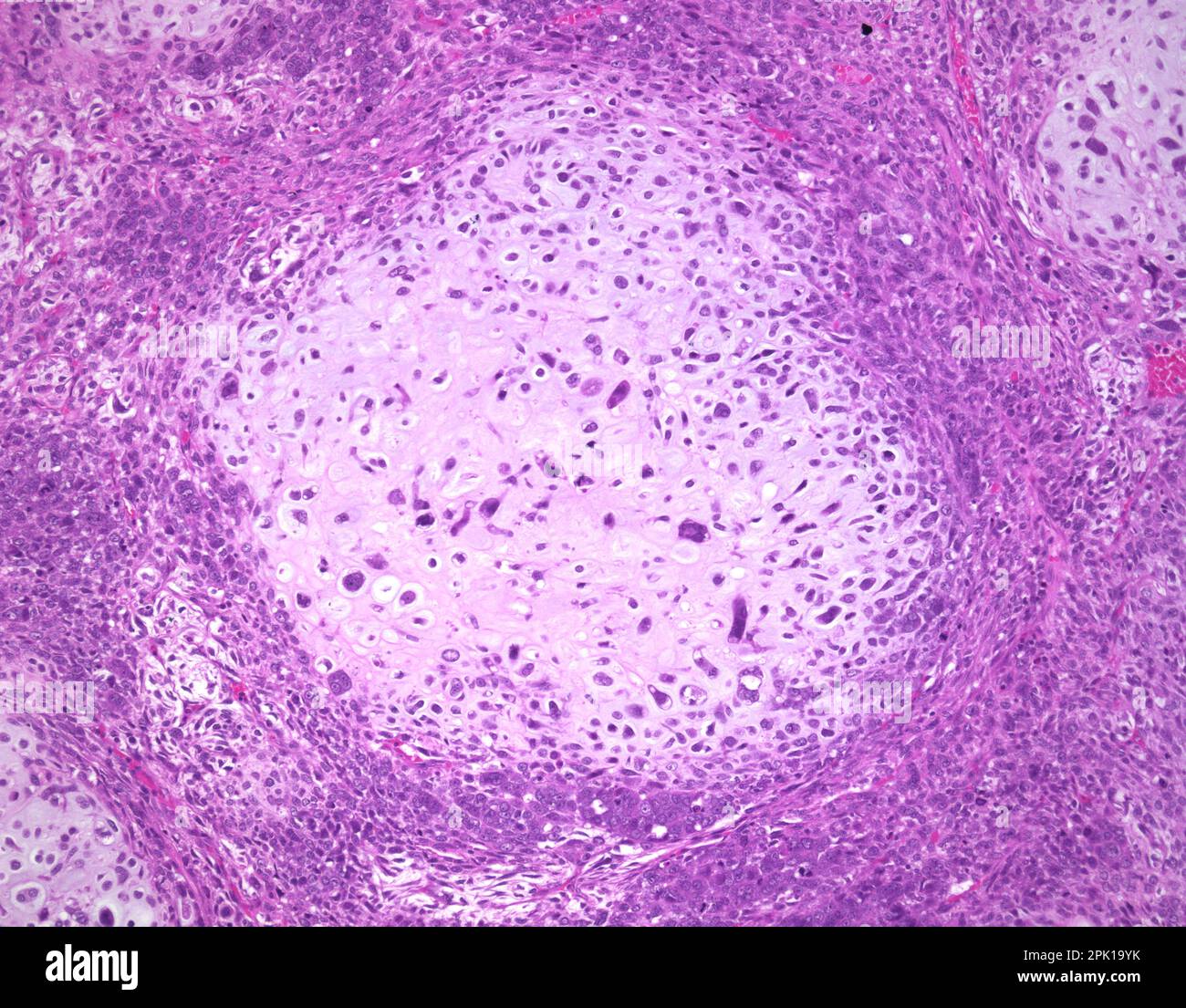 Carcinosarcoma, light micrograph Stock Photo - Alamy