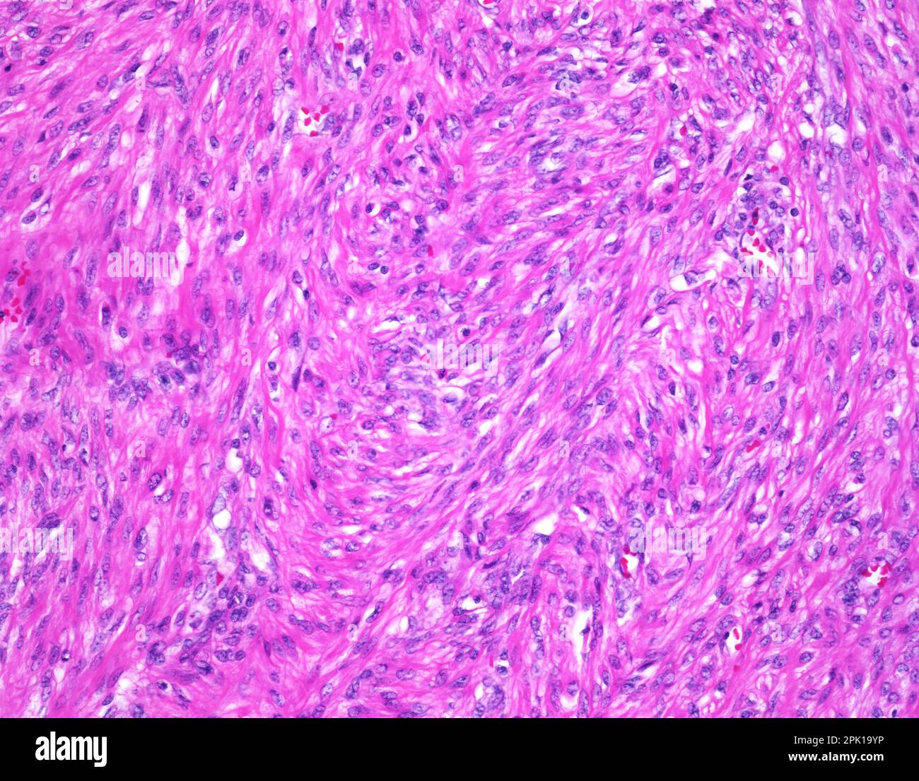 Uterine leiomyoma, light micrograph Stock Photo - Alamy