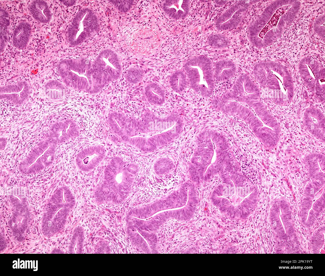 Atypical polypoid adenomyoma, light micrograph Stock Photo - Alamy