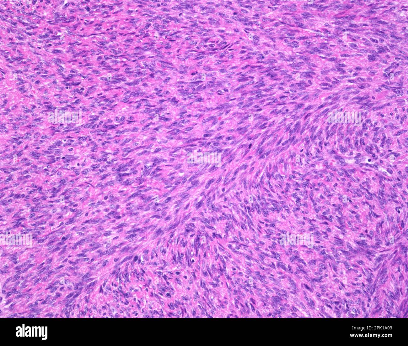 Uterine leiomyoma, light micrograph Stock Photo - Alamy