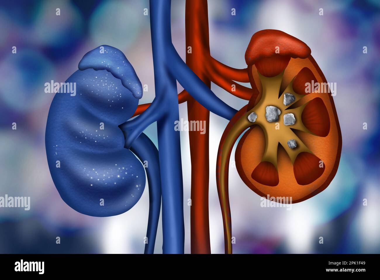 Illustration of healthy and diseased kidneys on blue background Stock ...