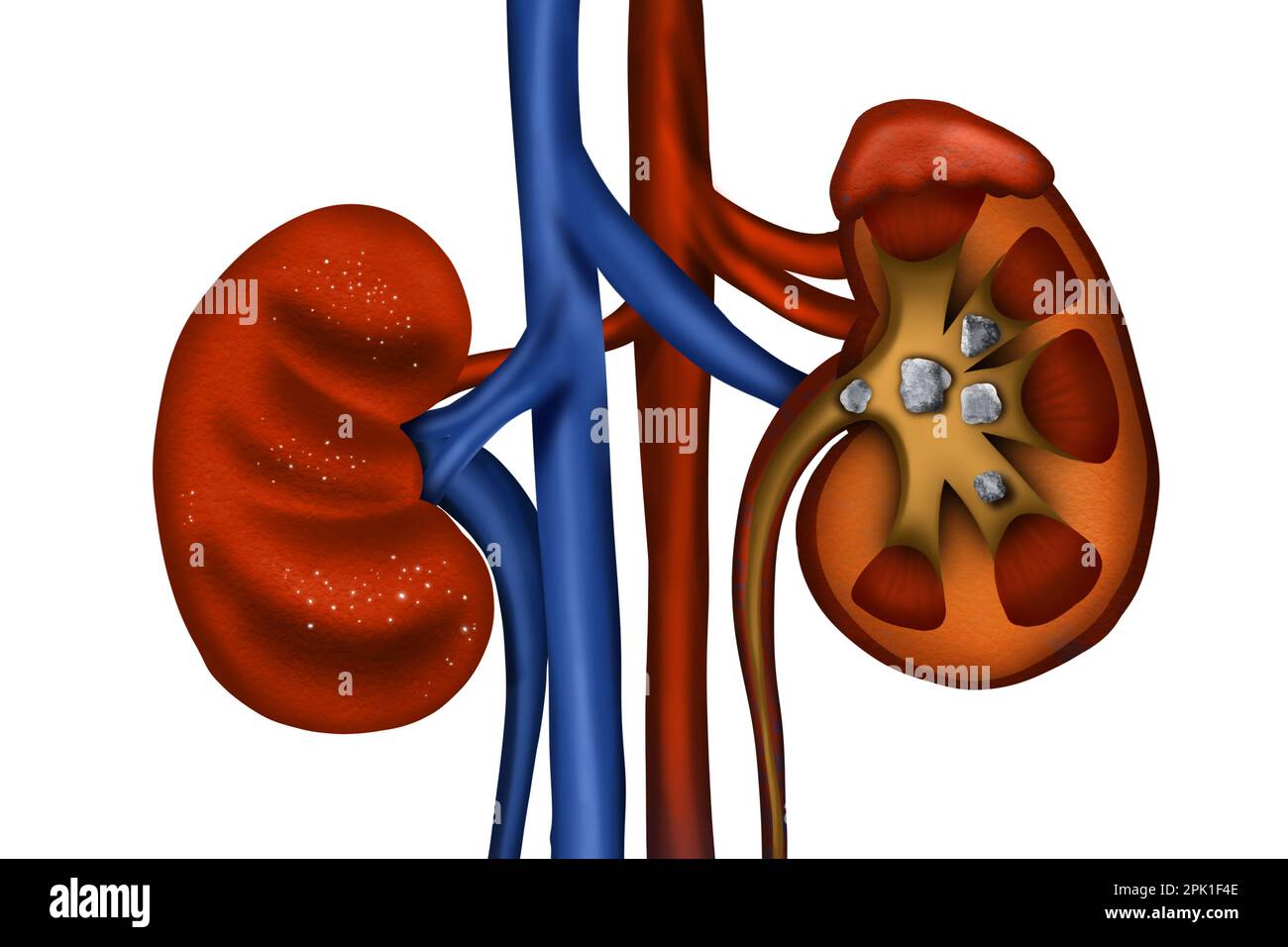 Illustration of healthy and diseased kidneys on white background Stock ...