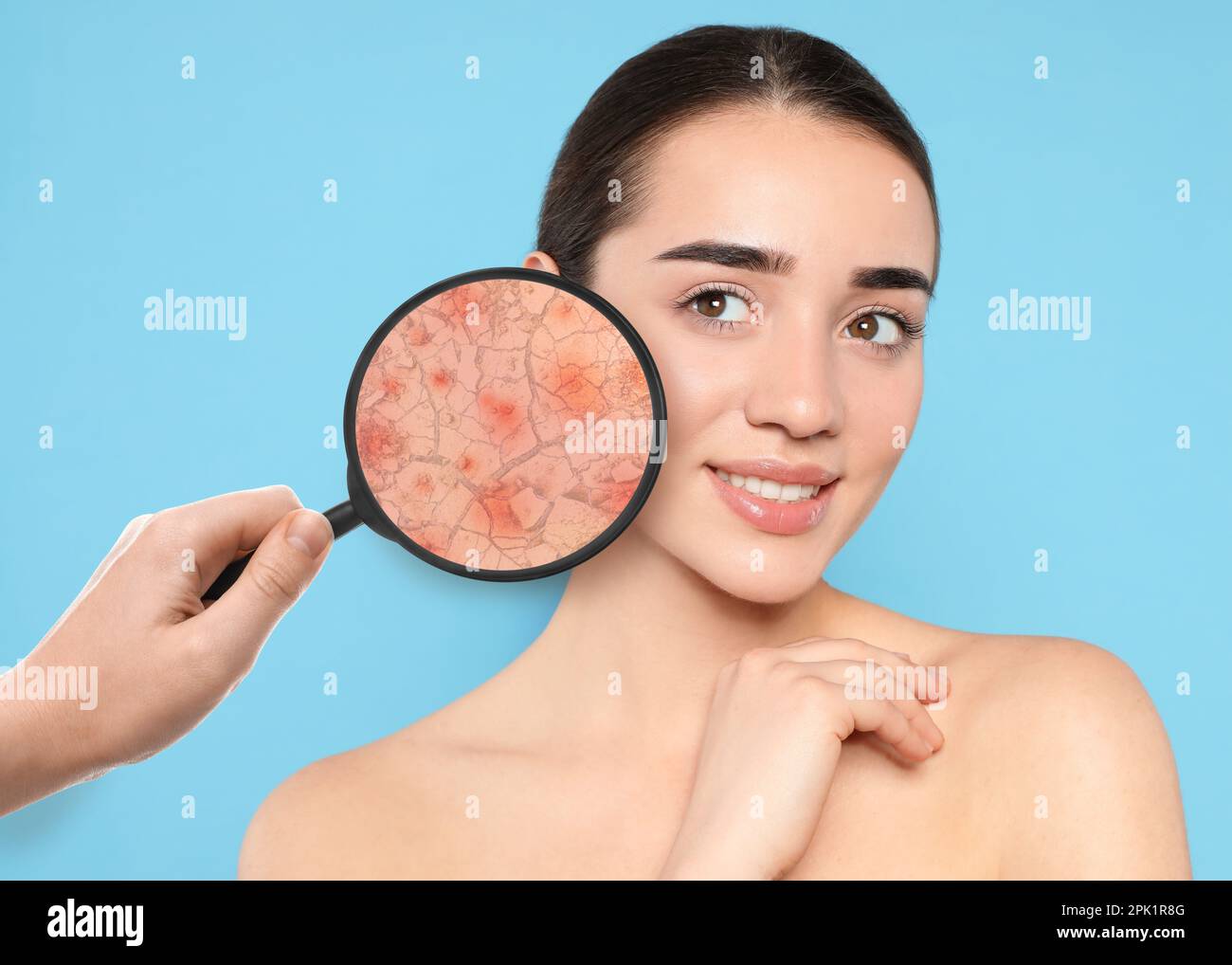 Young woman with facial dry skin problem on light blue background Stock ...