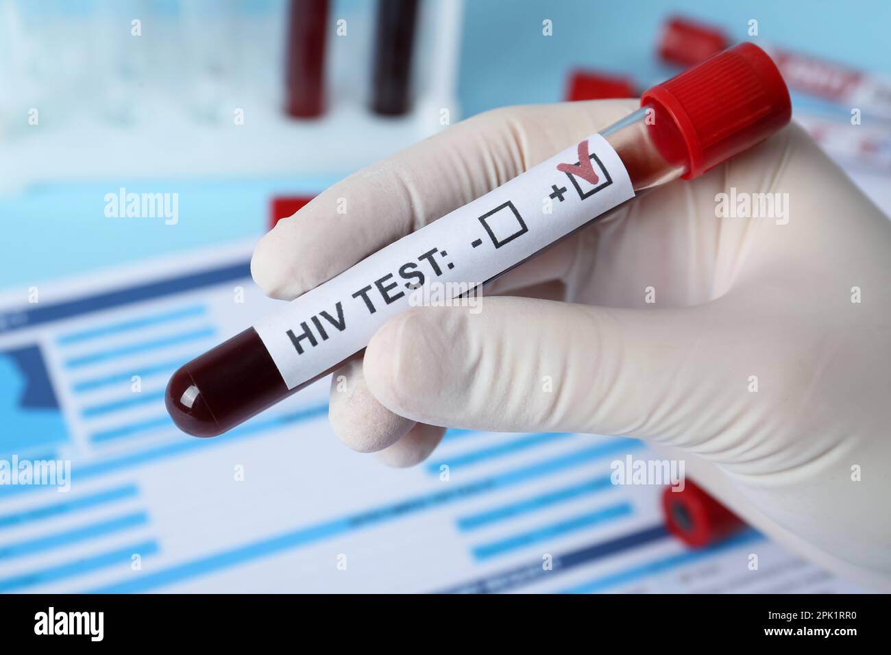 Scientist holding tube with blood sample and label HIV Test near ...