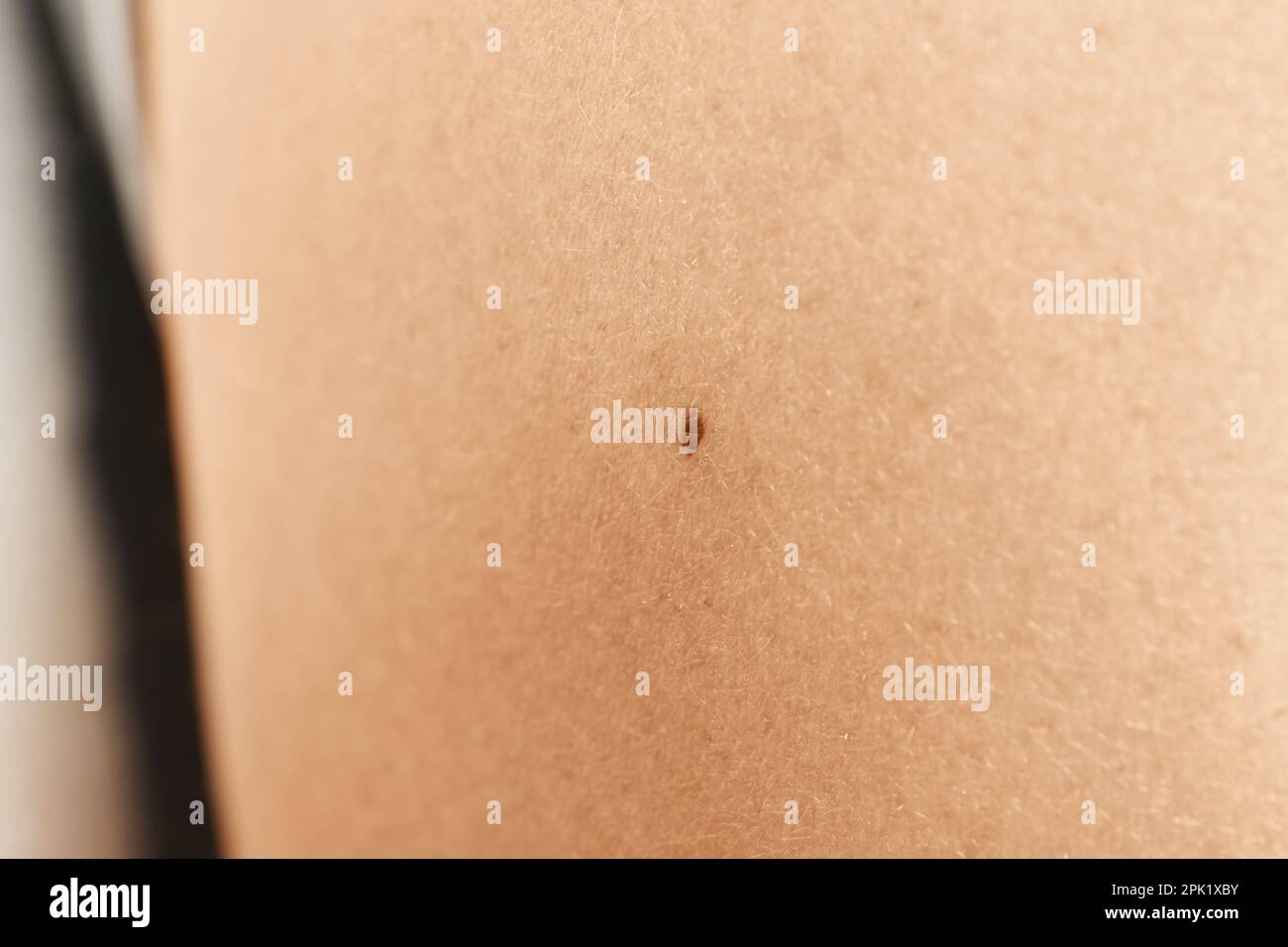 Closeup view of woman's body with birthmark Stock Photo - Alamy