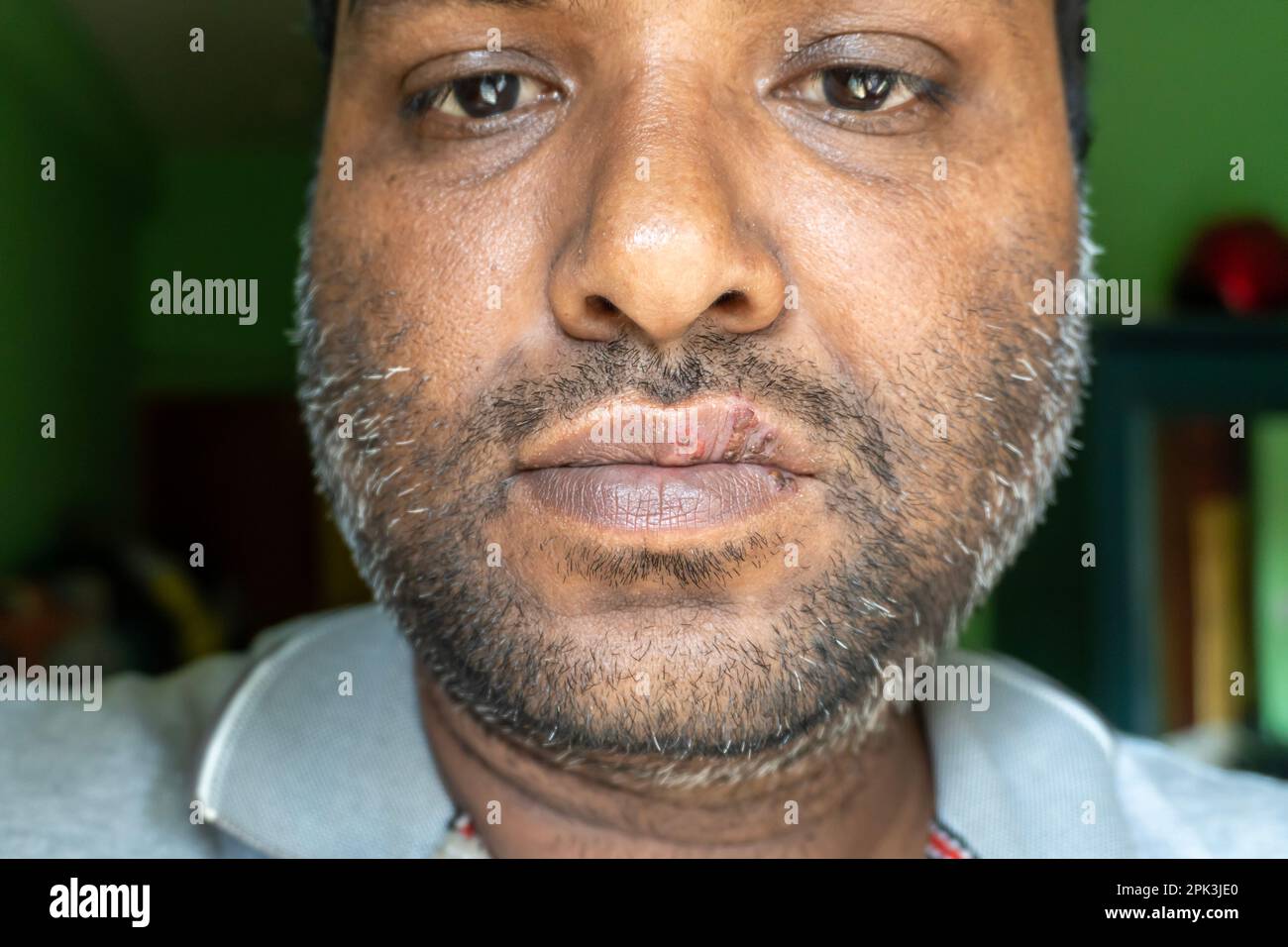 A Cold Sore On The Lip Of A Middle Aged Male A Middle Aged Mans Lips