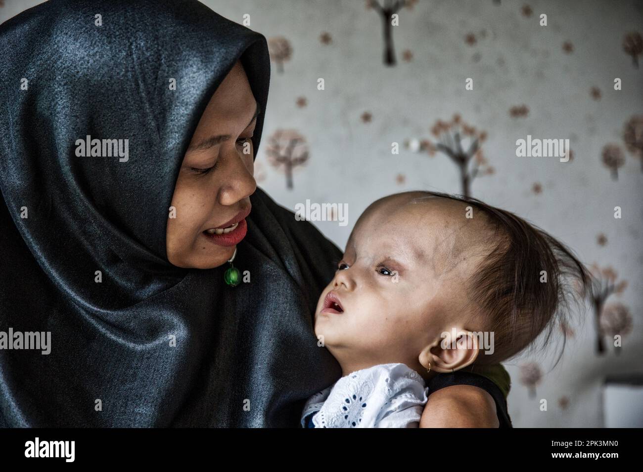 Hydrocephalus cerebrospinal fluid hi-res stock photography and images - Alamy