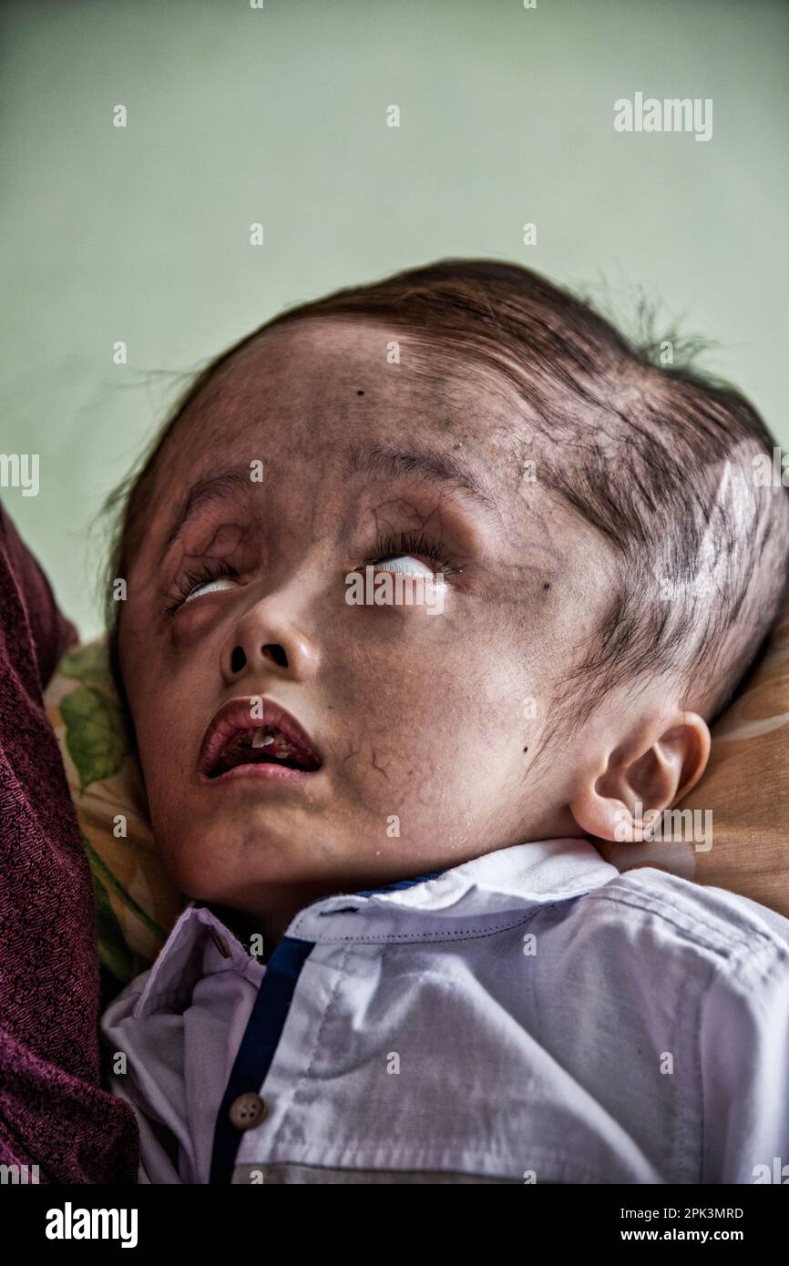 Hydrocefalus in asia hi-res stock photography and images - Alamy