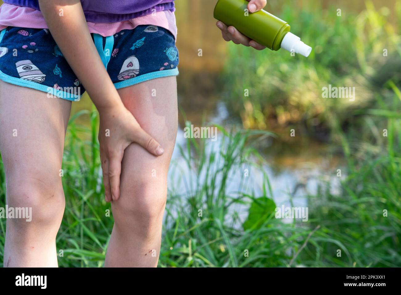 Girl sprays mosquito spray on the skin in nature that bite her hands ...